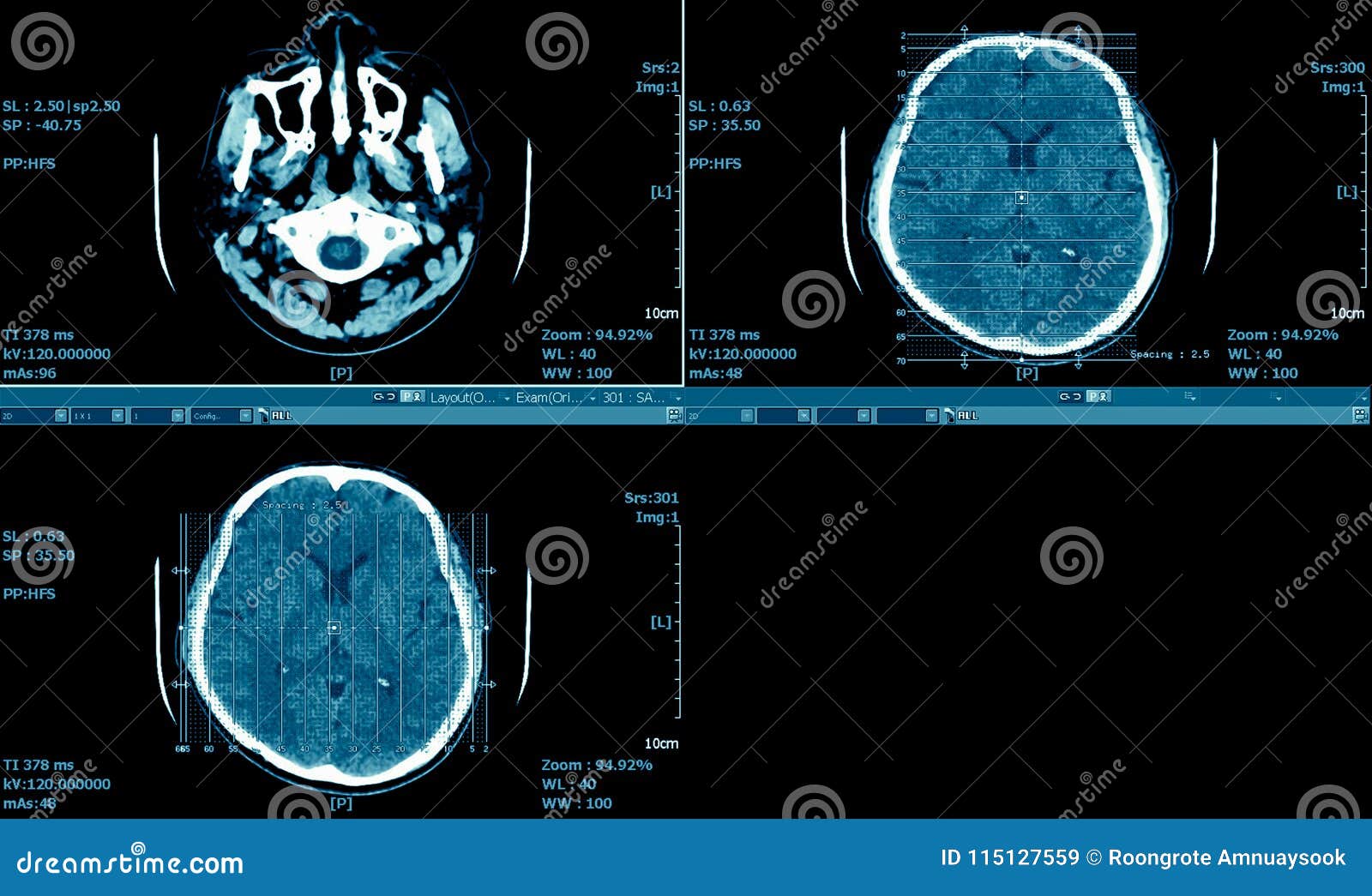 MRI Scan Of Brain,CT Scan Brain Series,Medical Background Stock Photo ...
