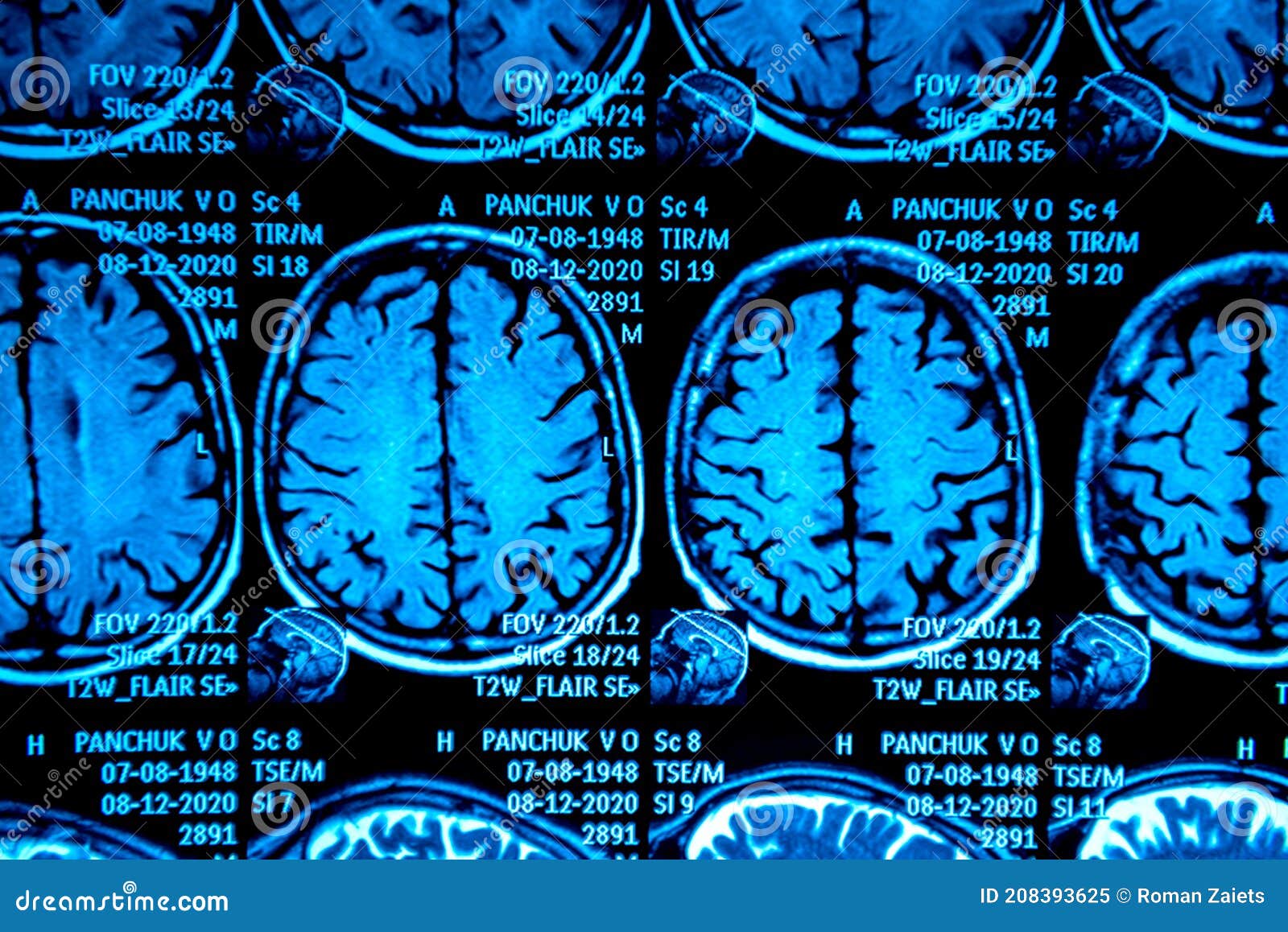 MRI Scan of the Brain. Magnetic Resonance Imaging Scan Stock Image ... MRI Scan of the Brain. Magnetic Resonance Imaging Scan Stock Image ...
