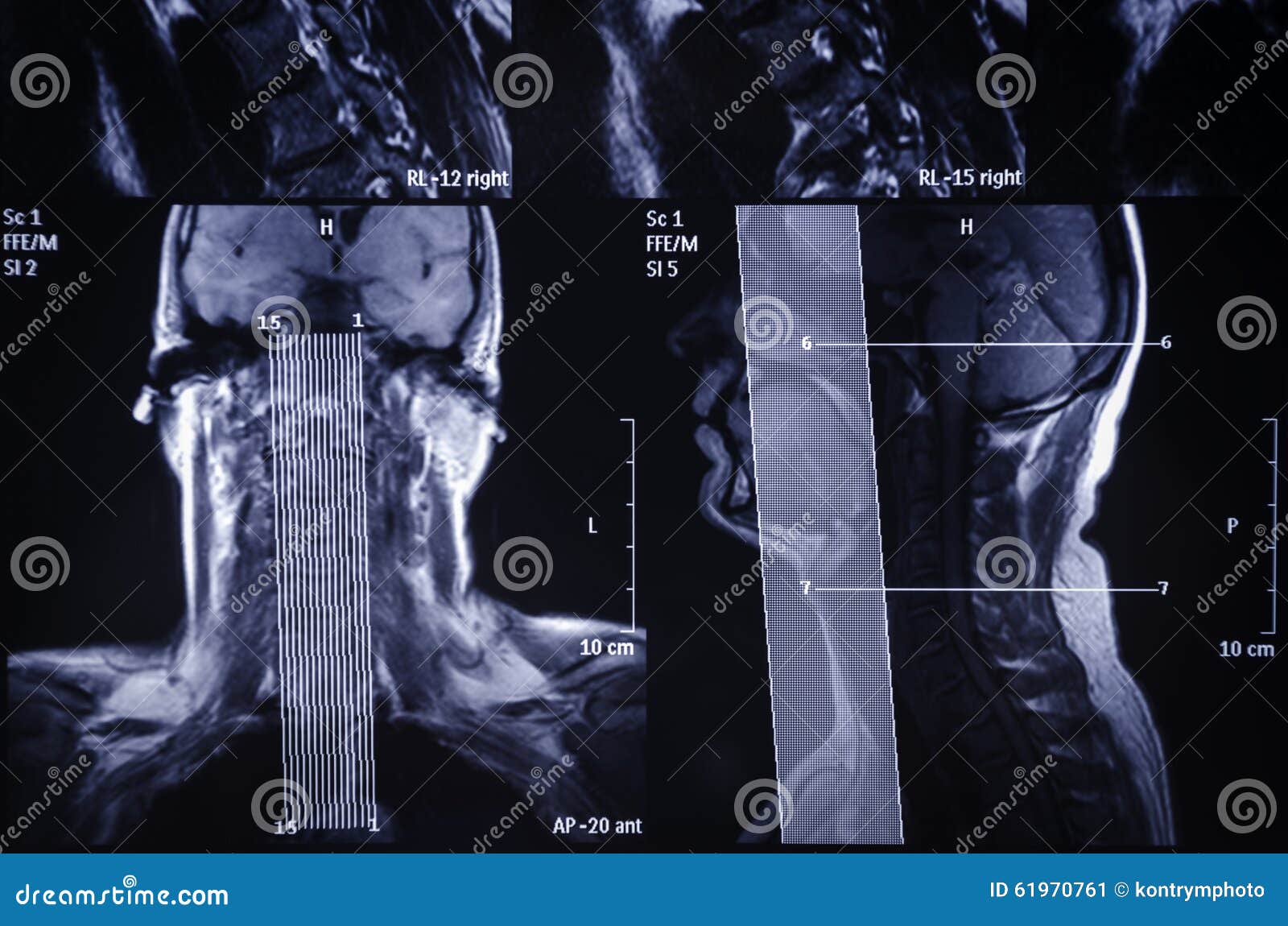 MRI scan stock image. Image of level, ischemia, body - 61970761