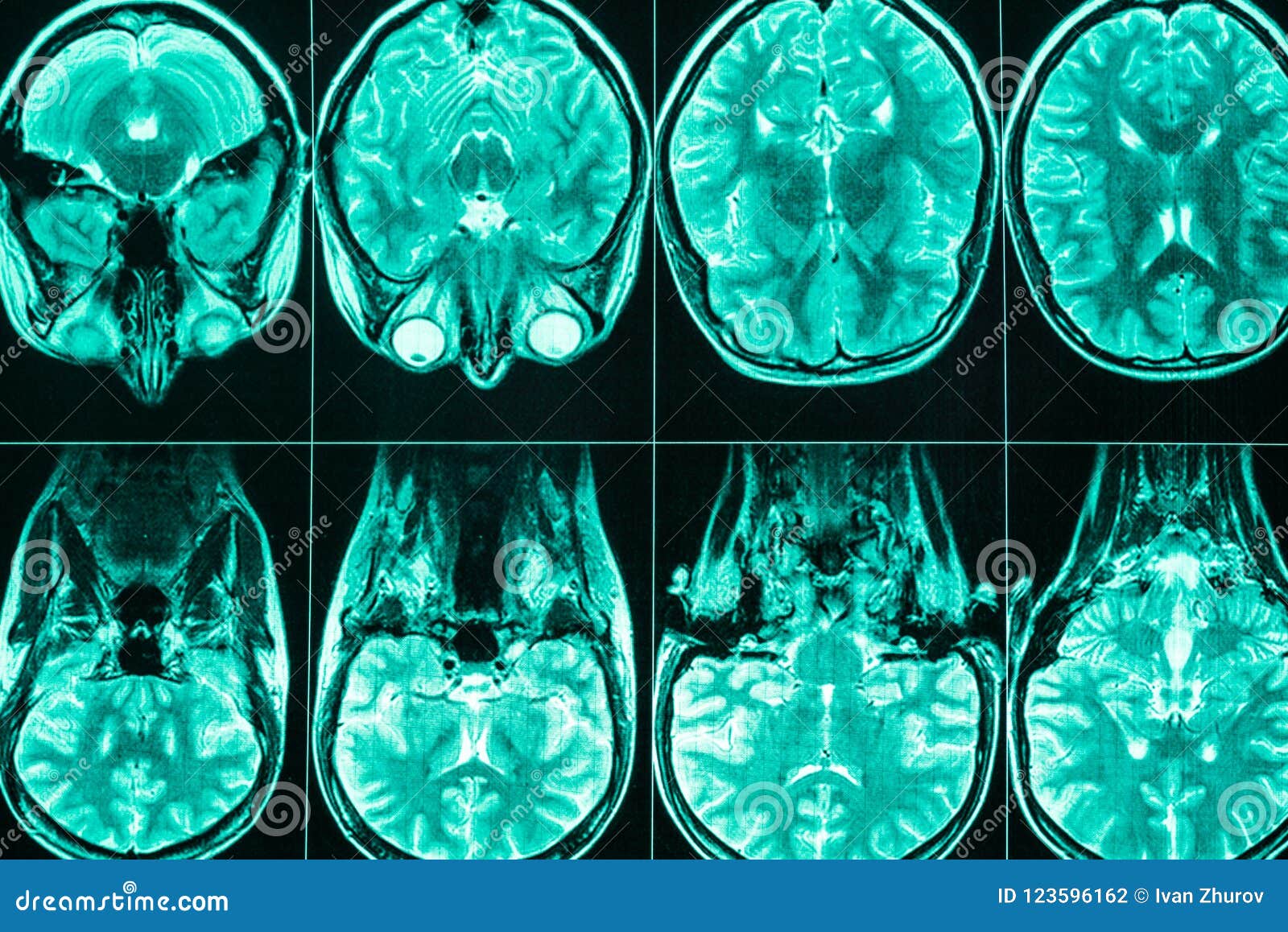 MRI Scan of the Head and Brain of a Person Stock Photo - Image of ...
