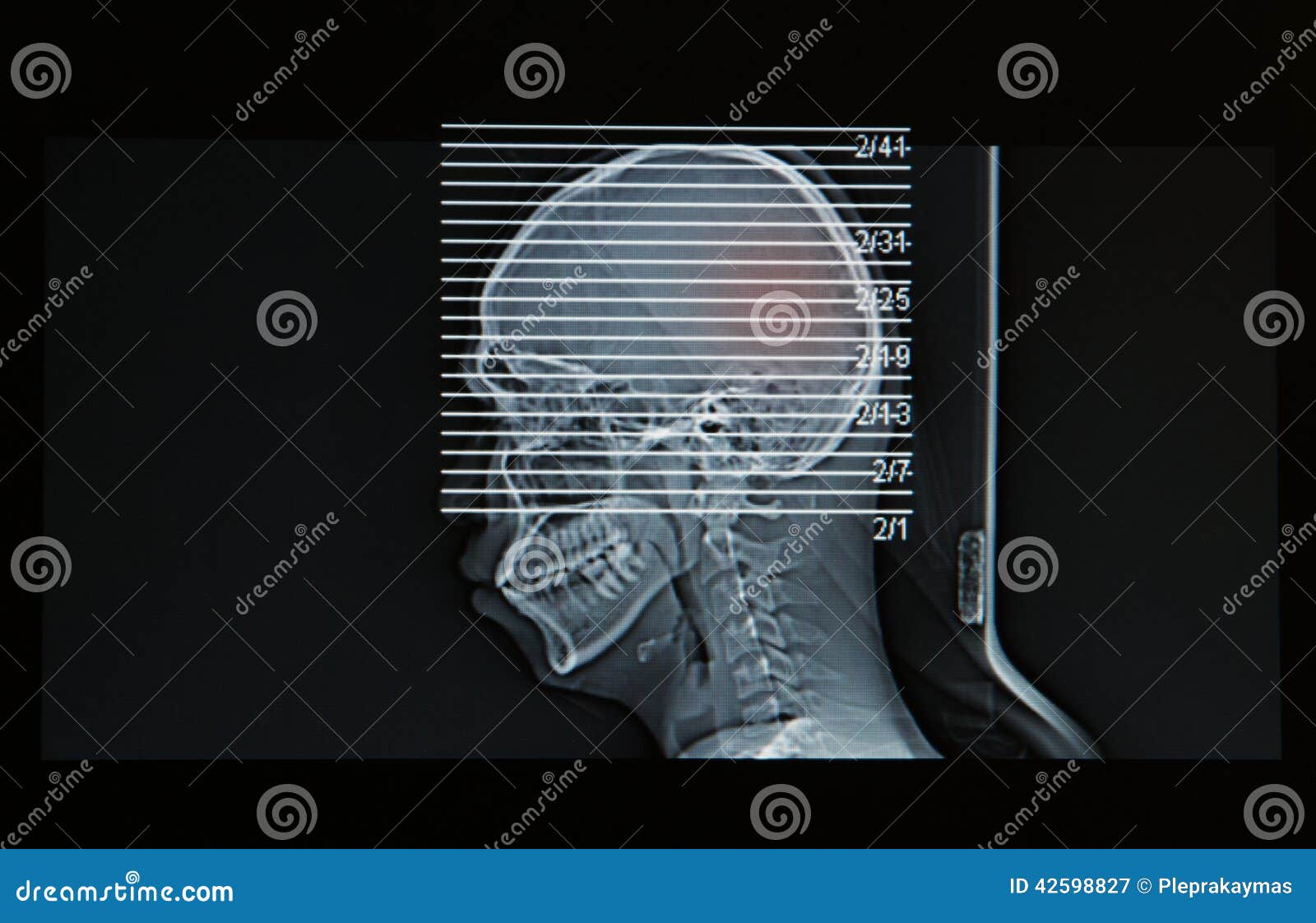 MRI Scan of Head of Human Show Head Injury Stock Image - Image of cross ...