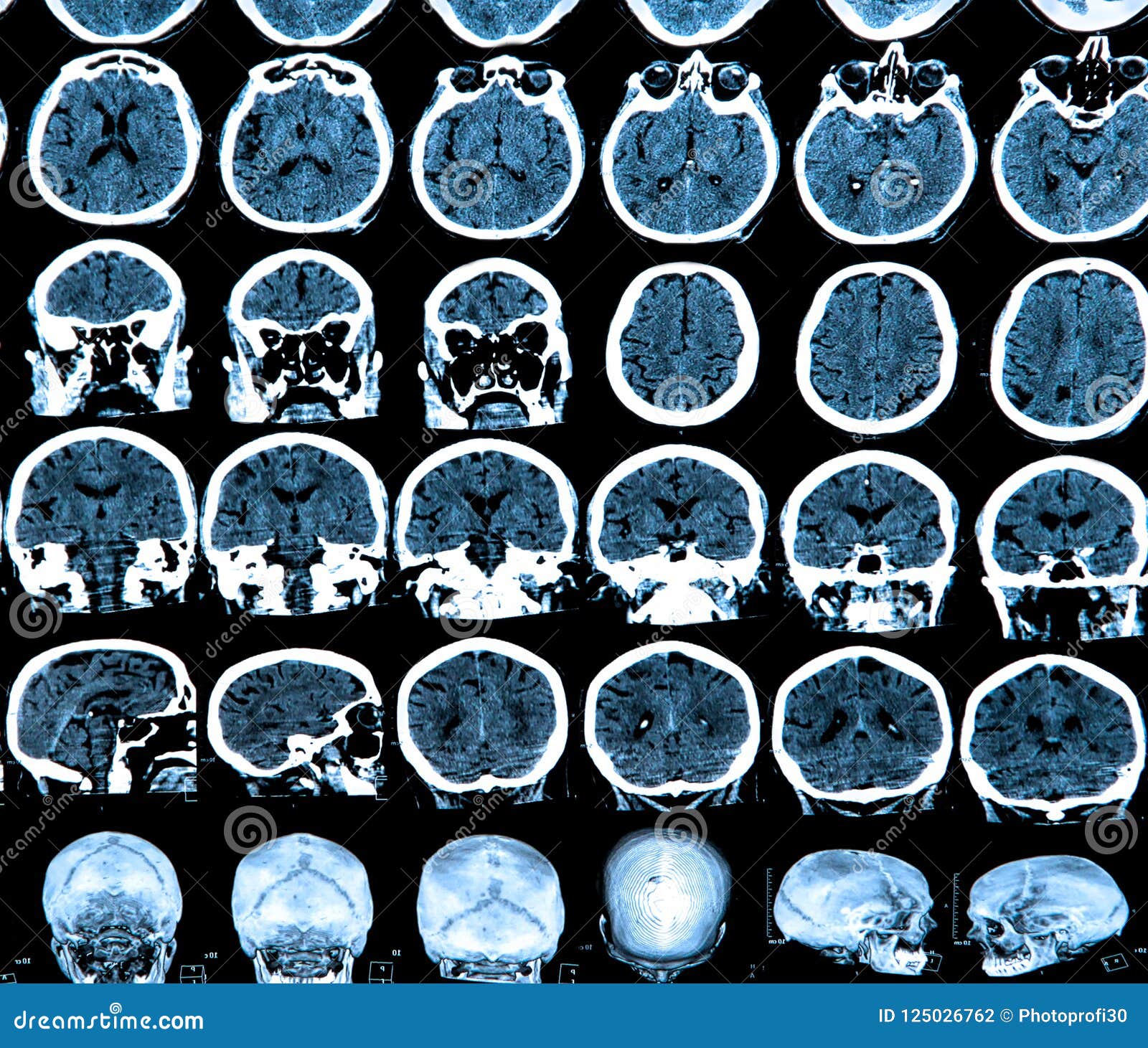 Mri Brain Scan editorial photography. Image of neural - 125026762