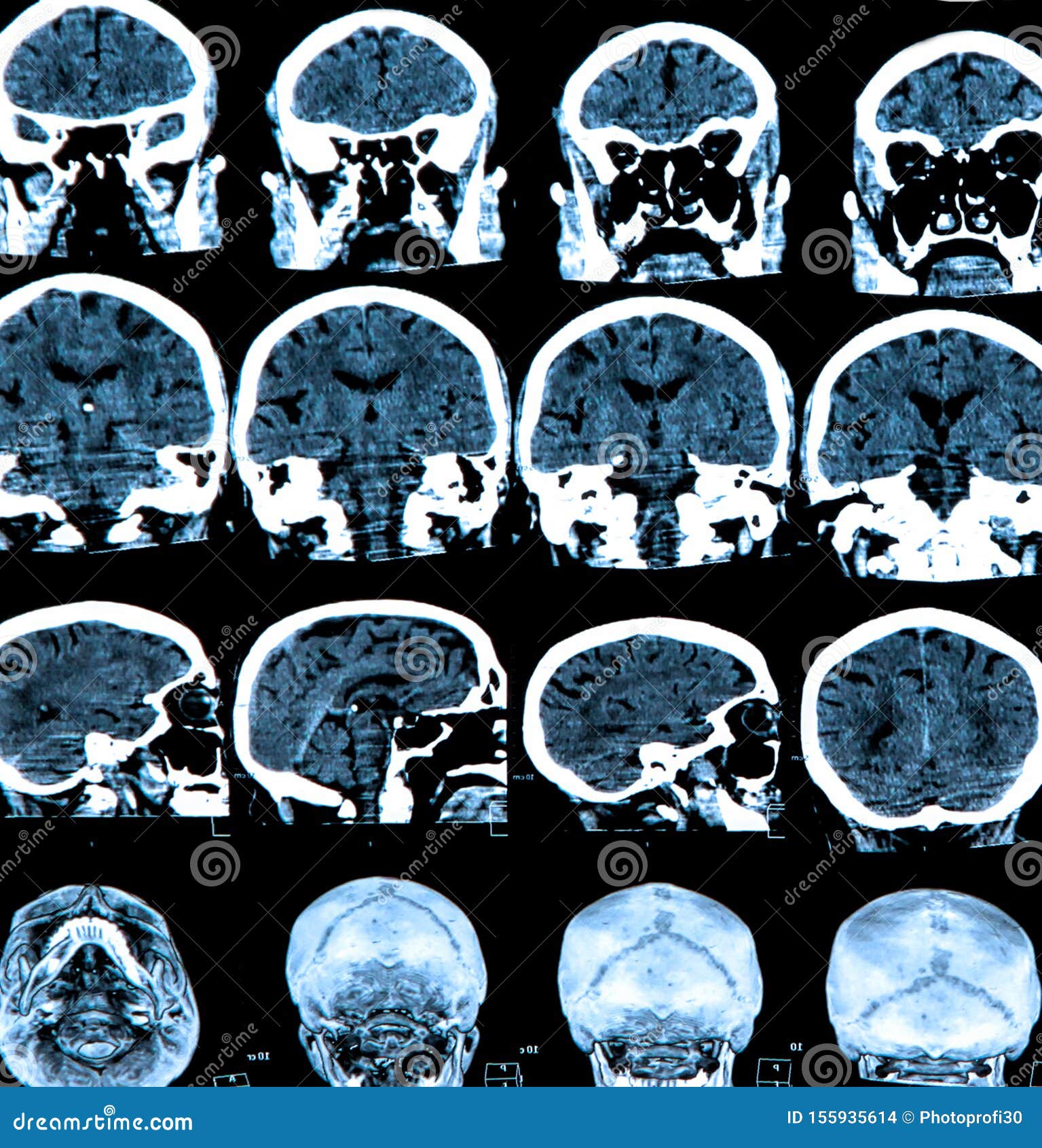 Mri Brain Scan stock photo. Image of cranium, medical - 155935614
