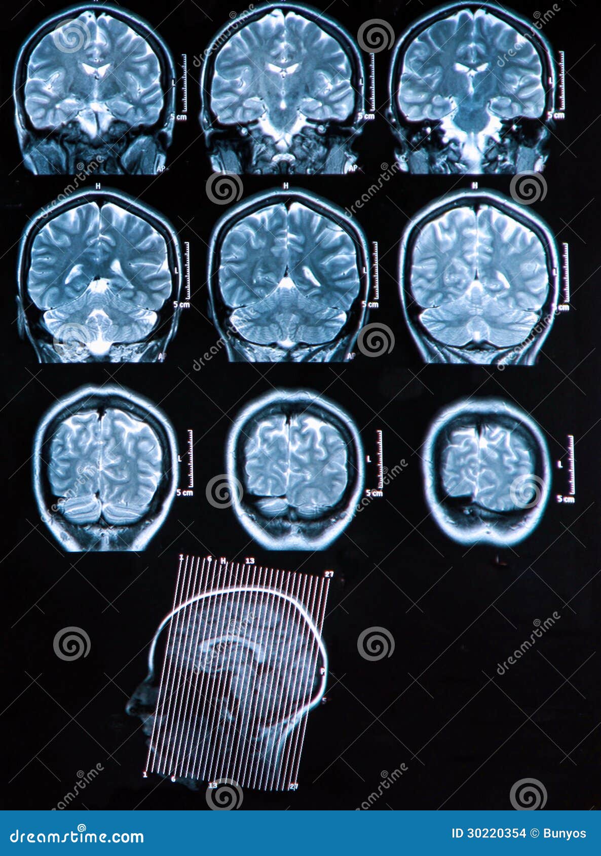 Mri Brain Scan stock photo. Image of imagery, gyri, hemisphere - 30220354