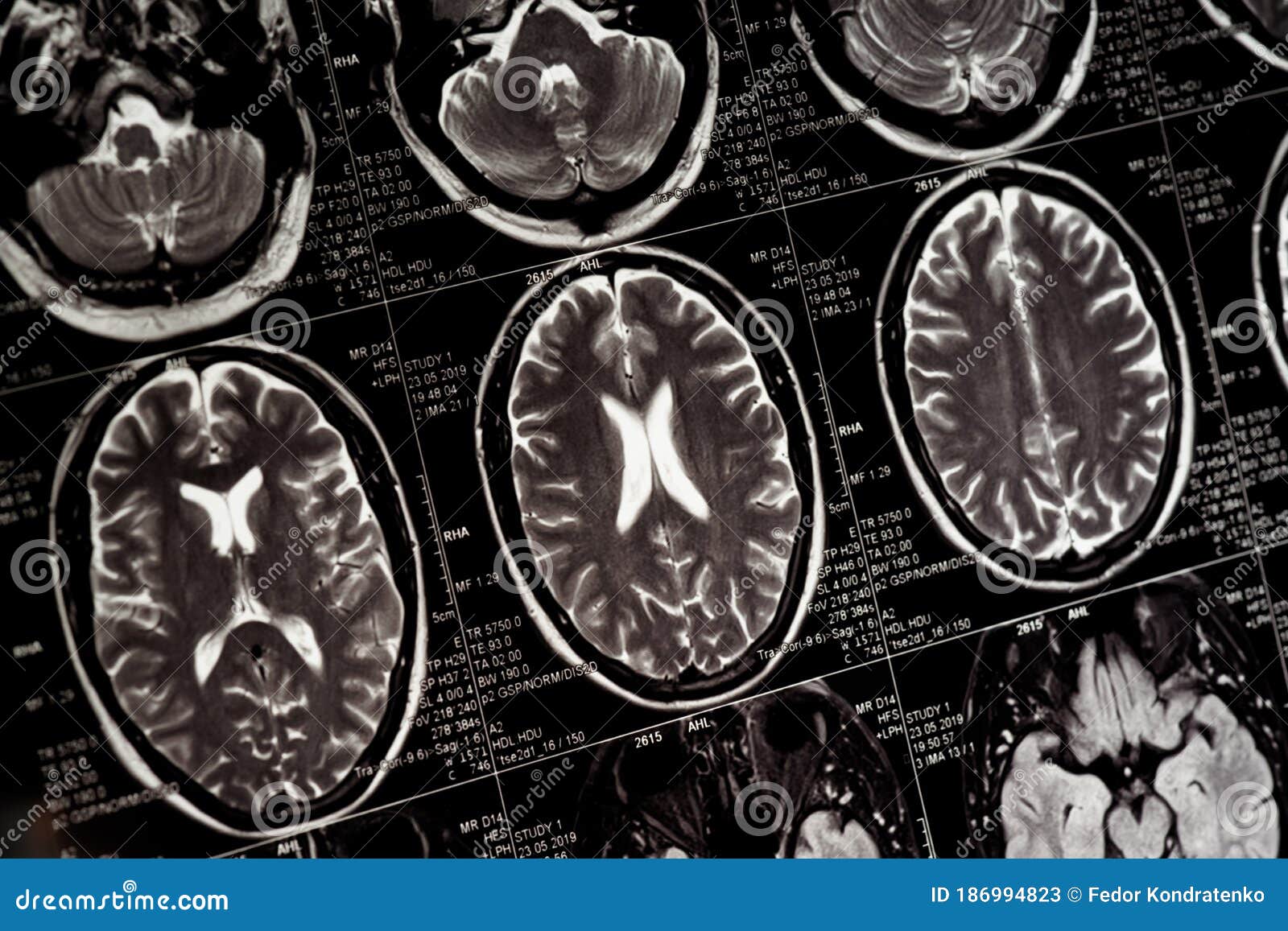 MRI scan of human brain stock image. Image of body, human - 186994823