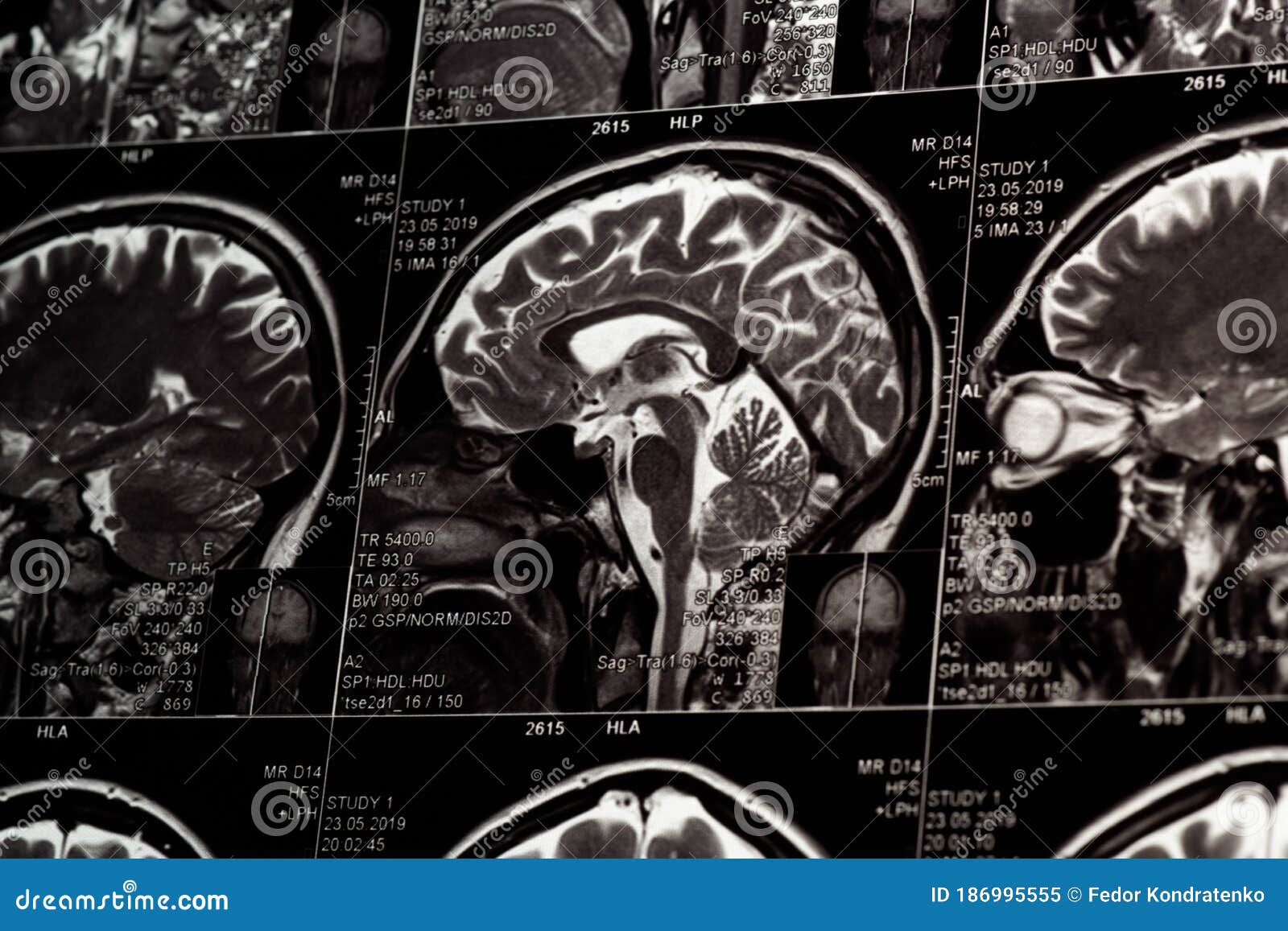 MRI scan of human brain stock image. Image of bone, radiology - 186995555