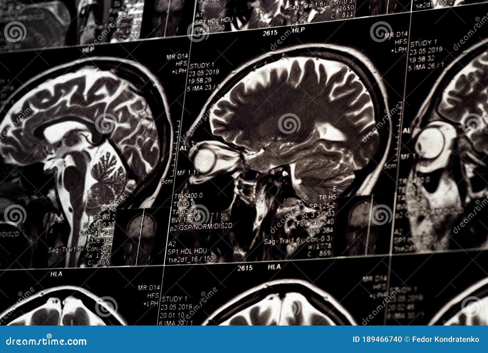 MRI scan of human brain stock photo. Image of healthcare - 189466740