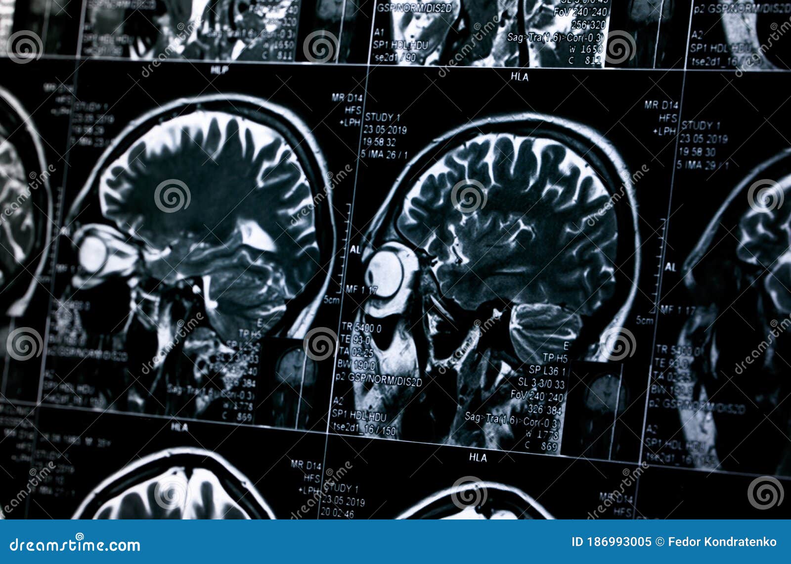 MRI scan of human brain stock image. Image of human - 186993005