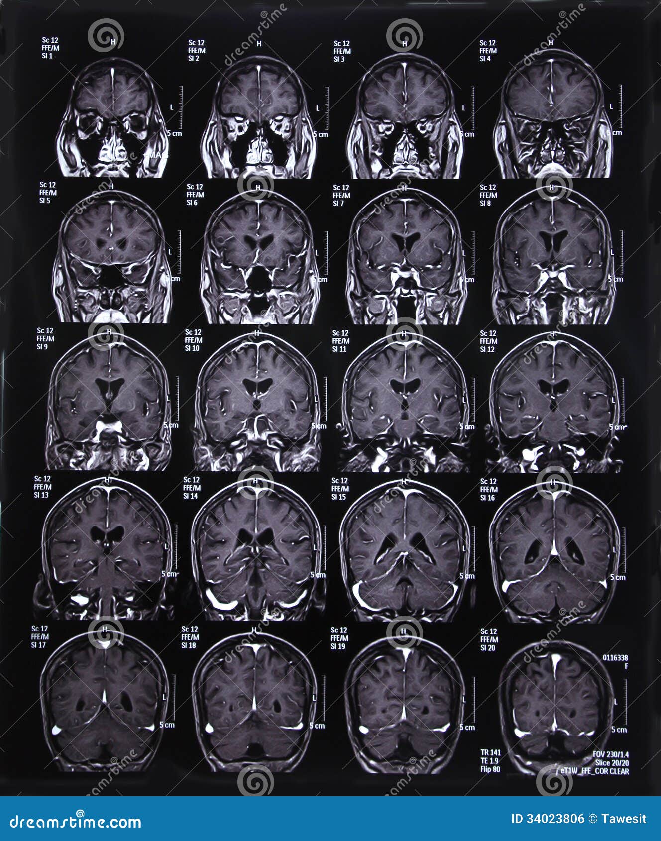 MRI scan image of brain stock photo. Image of diagnosis - 34023806