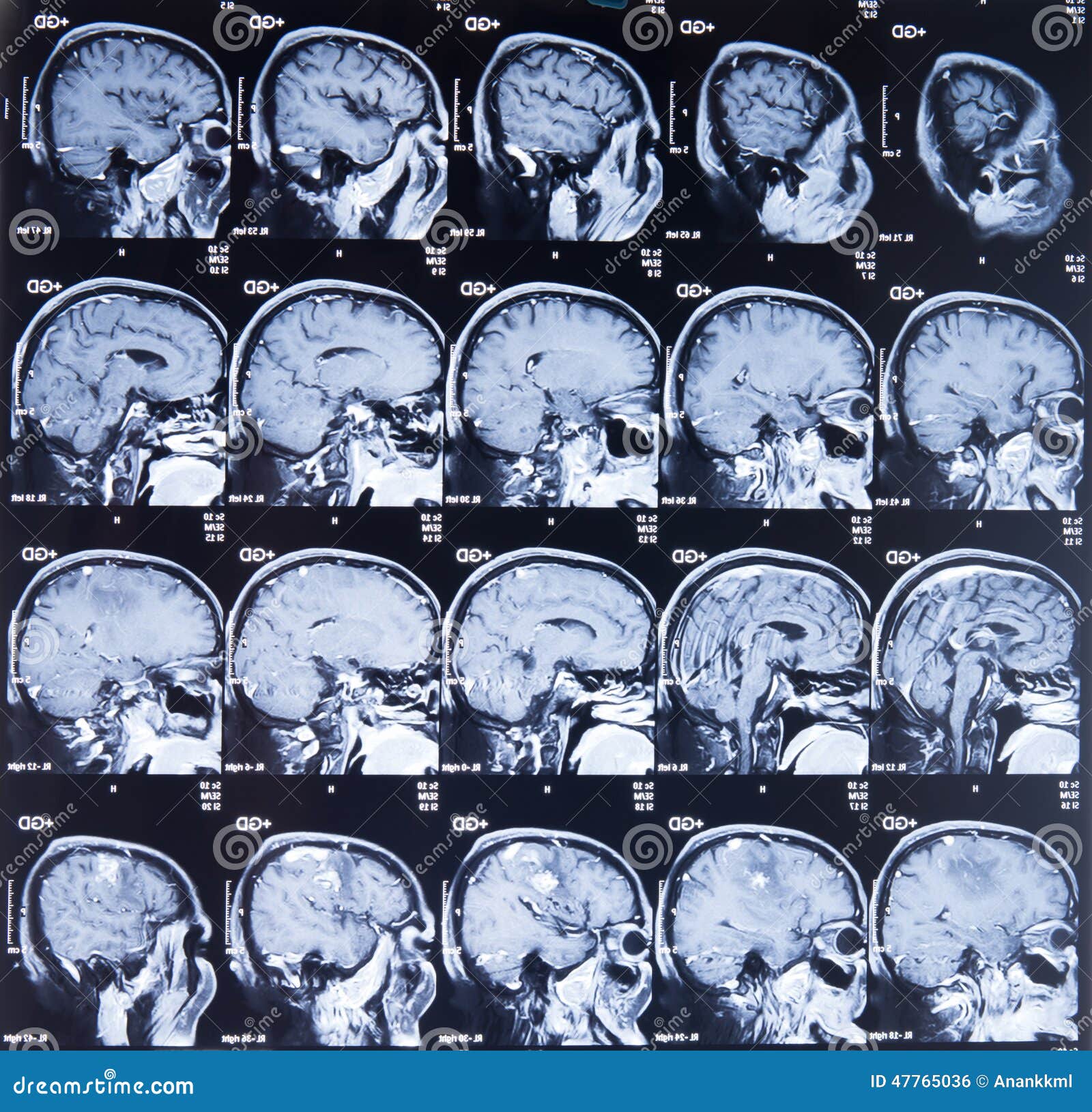 Mri scan image stock photo. Image of person, diagnosis - 47765036