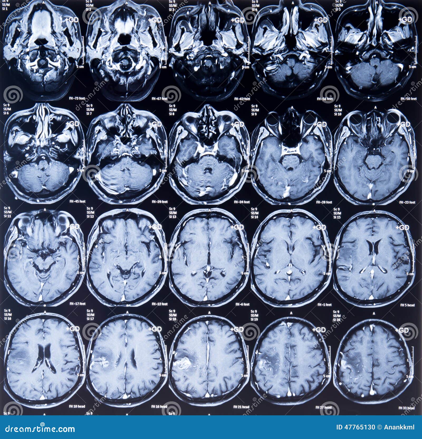 Mri scan image stock photo. Image of resonance, body - 47765130