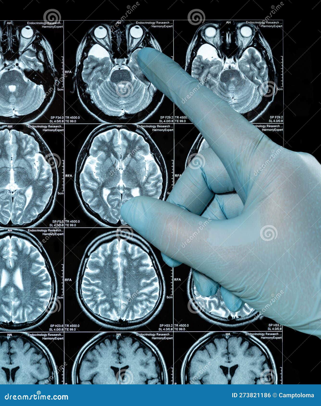 MRI Scan Image of a Human Brain Showing All Main Multiple Sclerosis ...