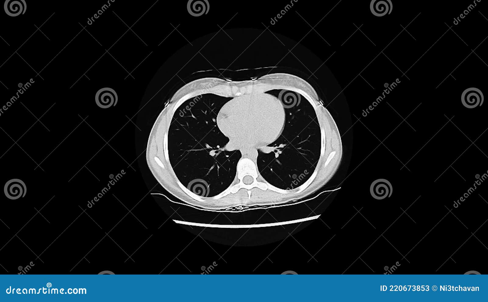MRI Scan of the Lungs. CT Scan Computed Tomography of Chest with ...