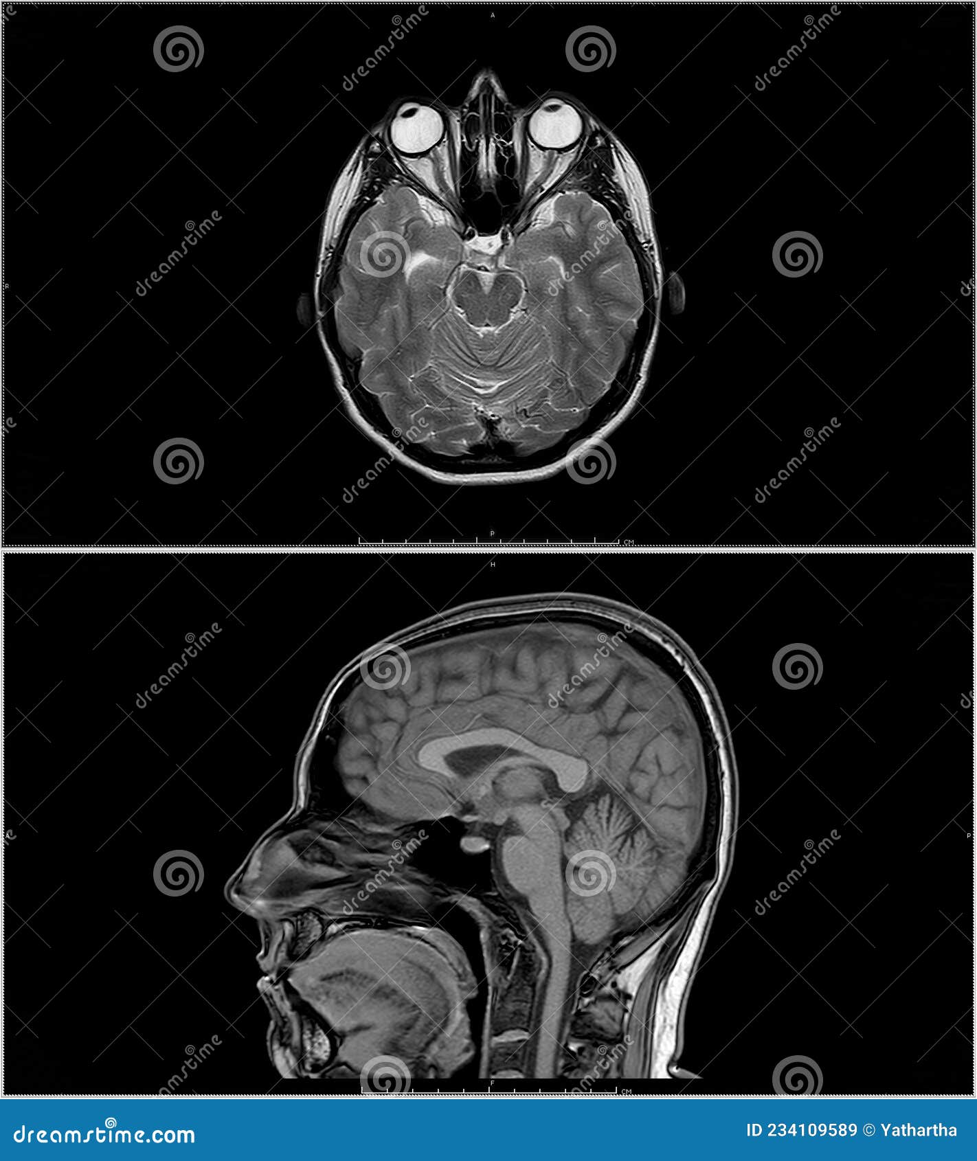 MRI Scan or Magnetic Resonance Image of Head. Problems with the Brain ...
