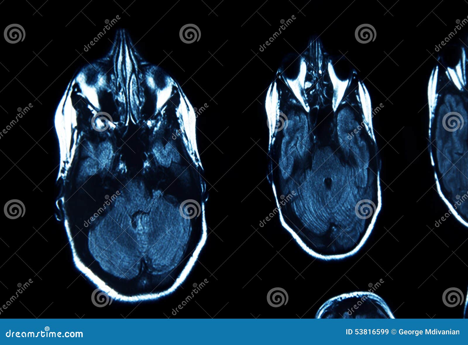 Mri scan stock image. Image of black, disease, care, technology - 53816599