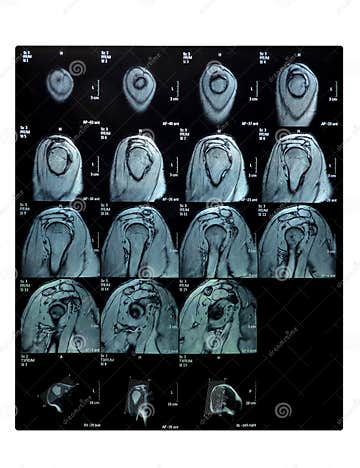MRI Scan - Shoulder - Side View Stock Photo - Image of magnetic ...