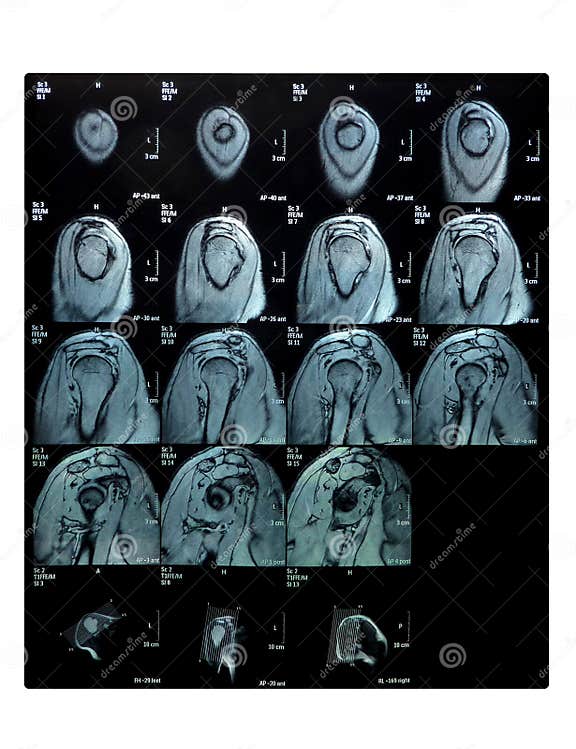 MRI Scan - Shoulder - Side View Stock Photo - Image of magnetic ...