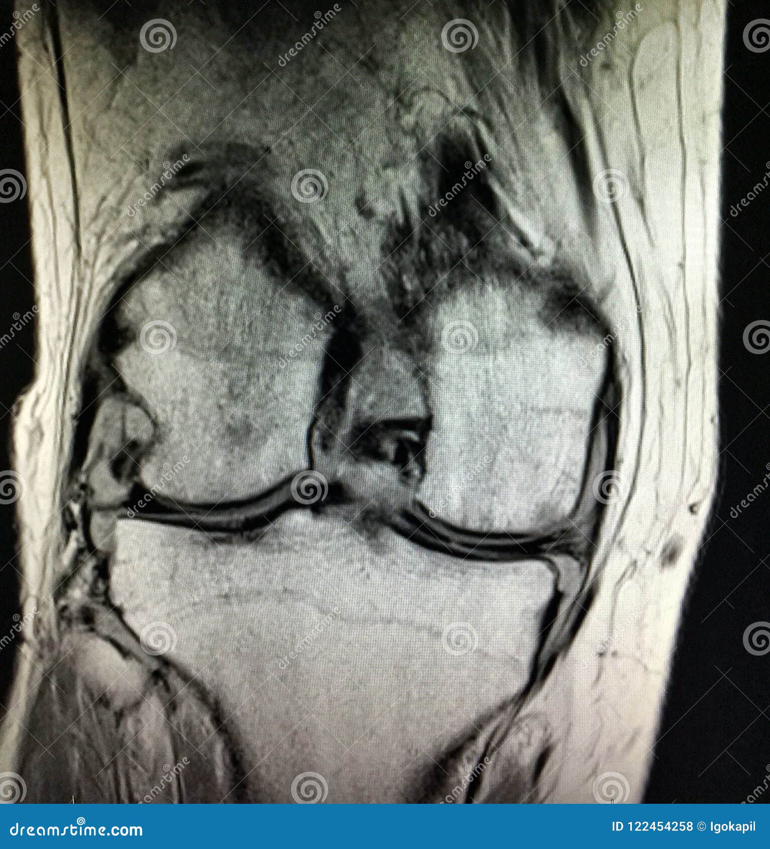 Mri Severo Do Synovitis Da Artrite Reumatoide Do Joelho Foto de Stock ...