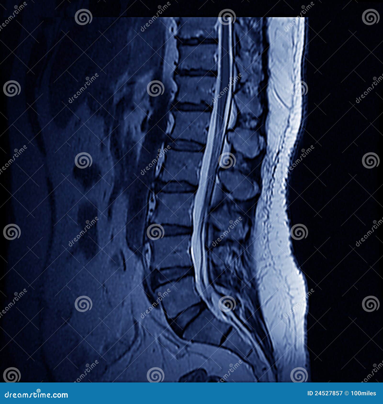MRI Spine stock image. Image of bones, diagnosis, disease - 24527857