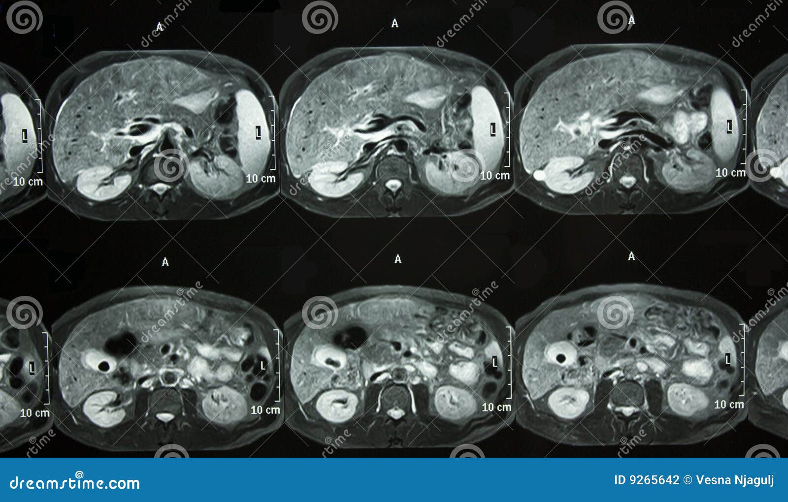 MRI van Buik stock foto. Image of medisch, lichaam, leven - 9265642