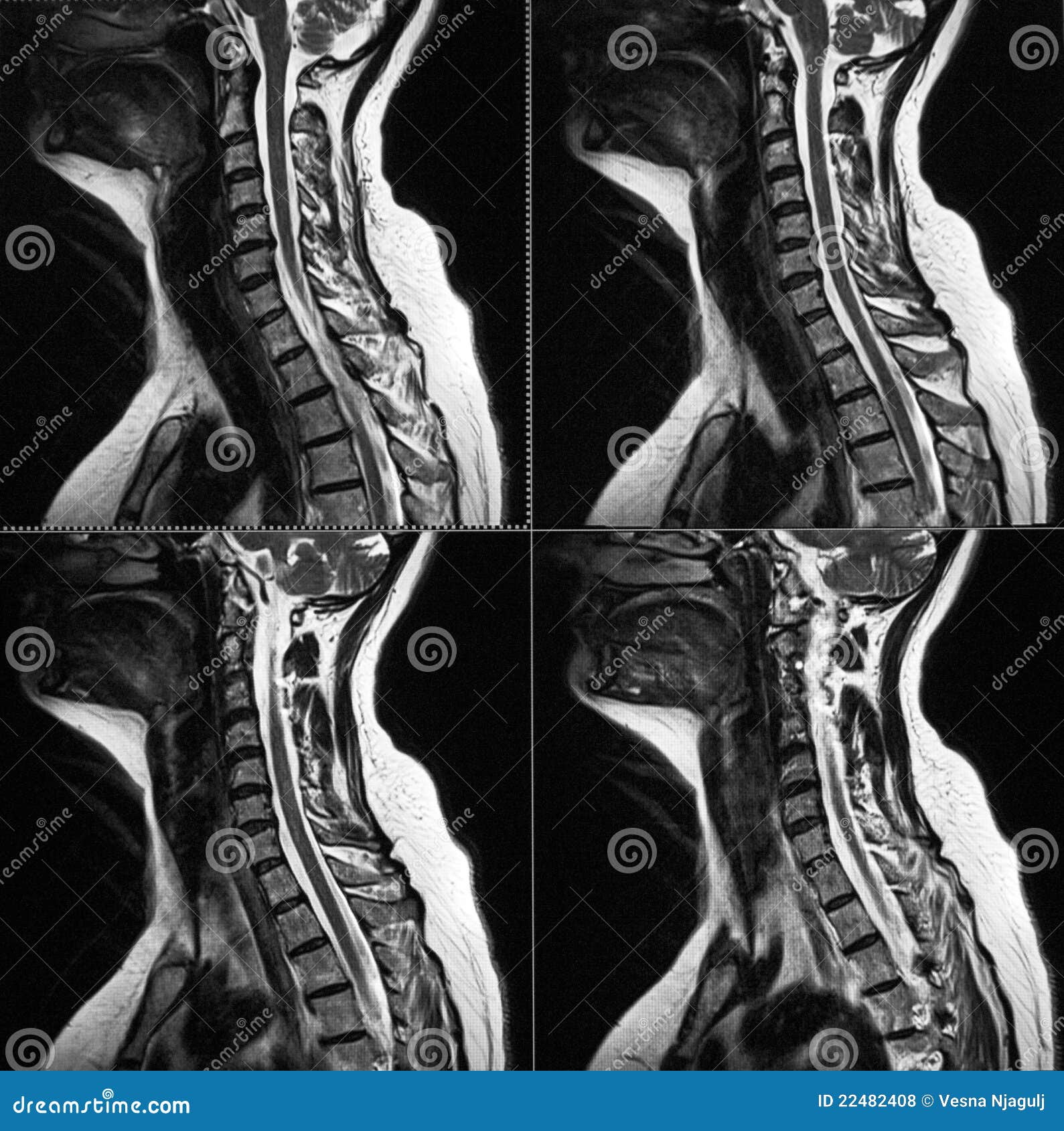 MRI Van Cervicale Stekel - Magnetische Resonantie Stock Foto - Image of ...