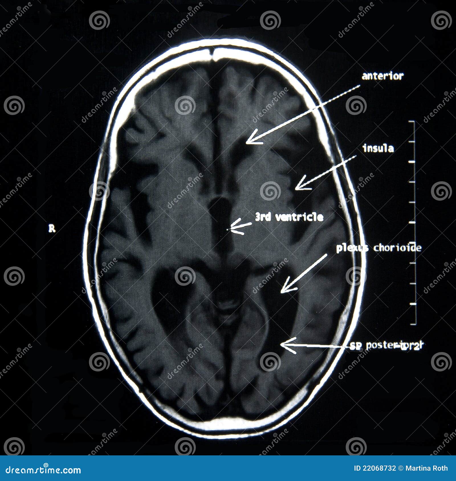 MRI van de hersenen stock foto. Afbeelding bestaande uit kliniek - 22068732