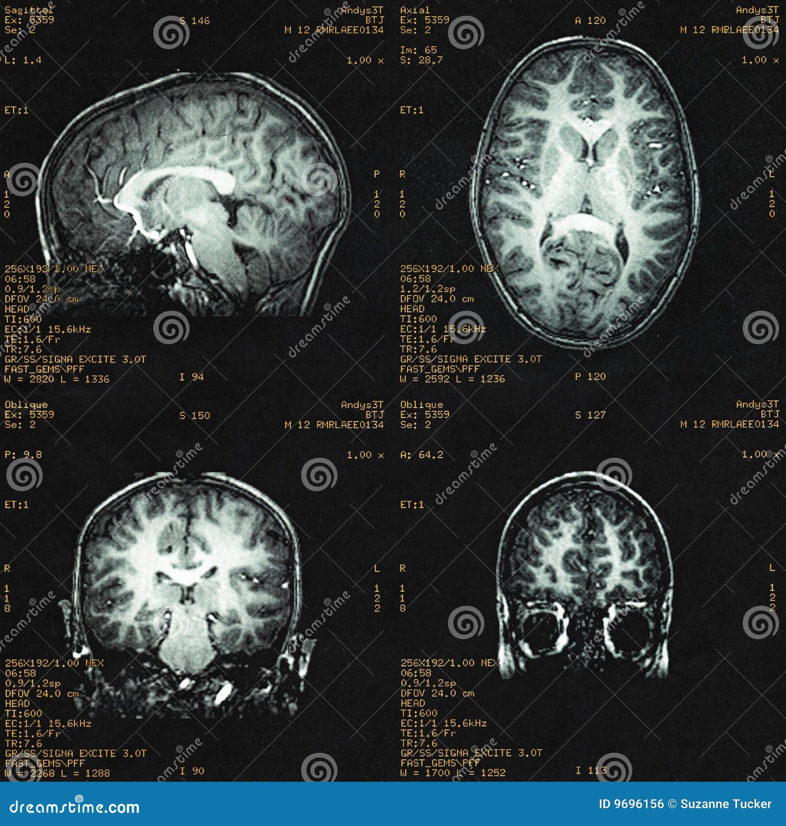 MRI Van De Hersenen Van Een Kind Stock Foto - Image of test, weergave ...