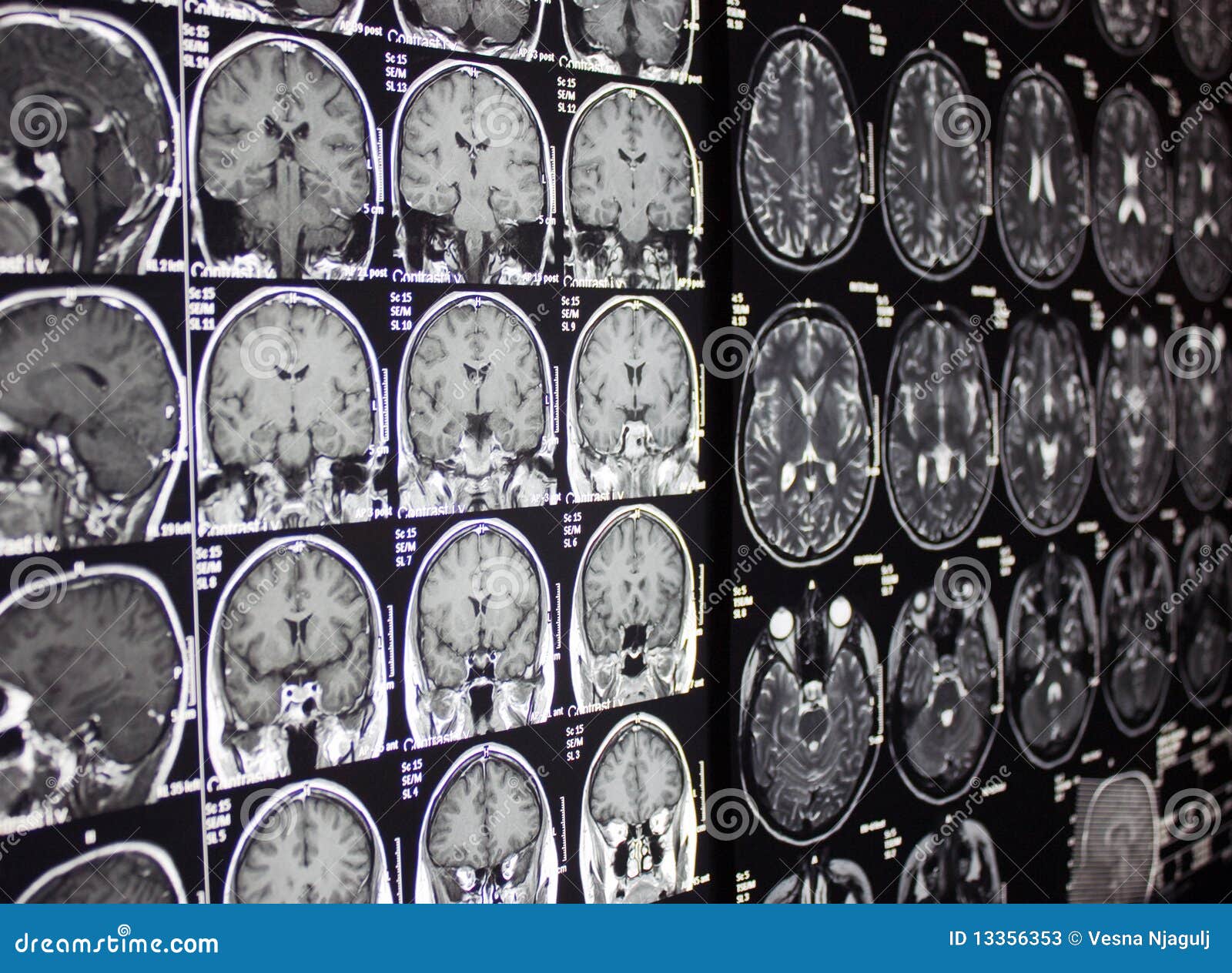 MRI van hersenen stock afbeelding. Image of studie, technologie - 13356353
