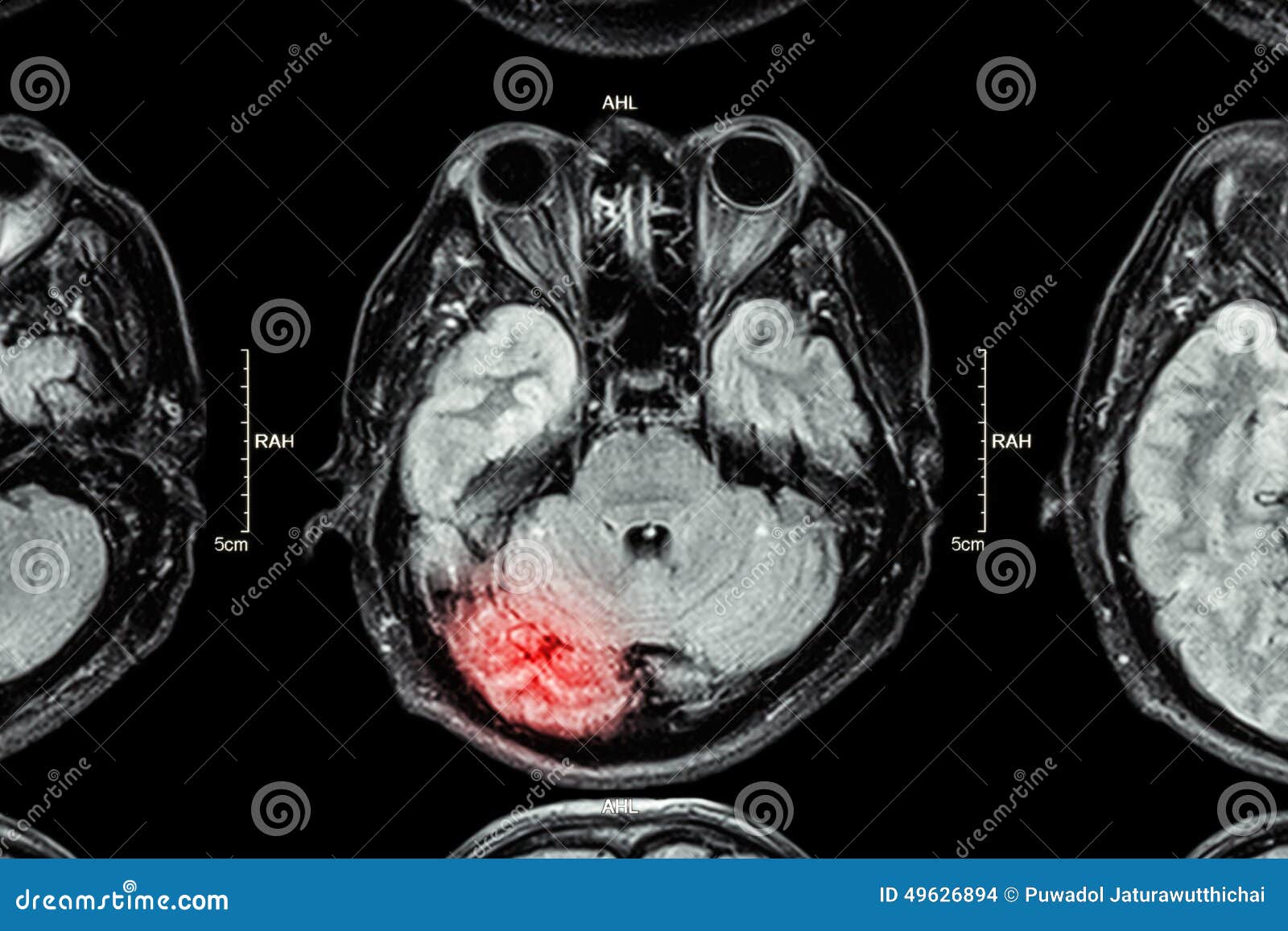 MRI Van Hersenen: Hersenenverwonding Stock Foto - Image of geneeskunde ...