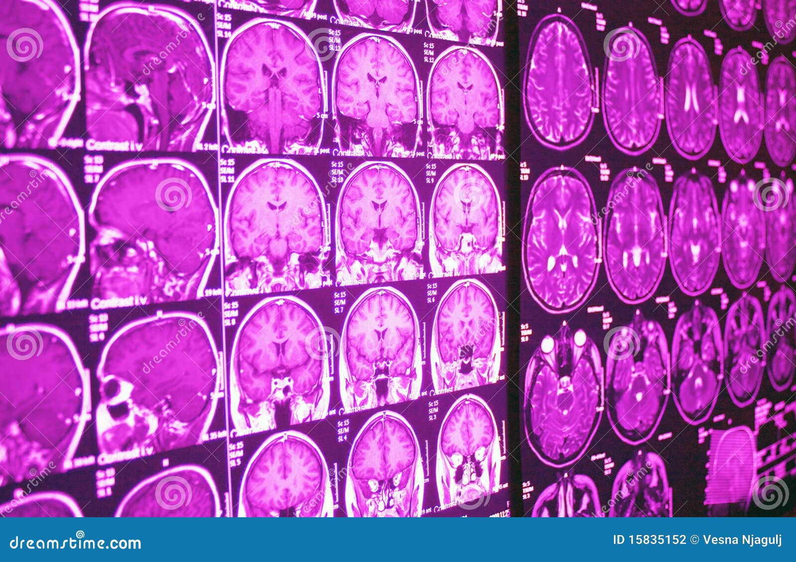 MRI van hersenen, M. stock foto. Image of magnetisch - 15835152