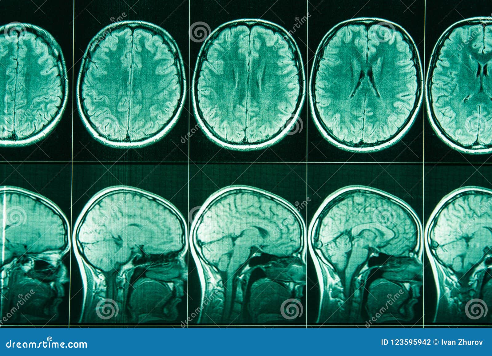 MRI Van Het Hoofd En De Hersenen Van Een Persoon Stock Foto - Image of ...