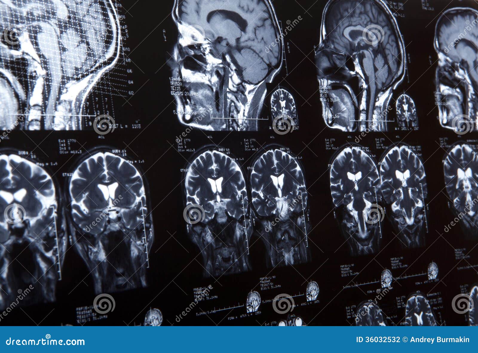 MRI Van Menselijke Hersenen Stock Foto - Image of kanker, straal: 36032532