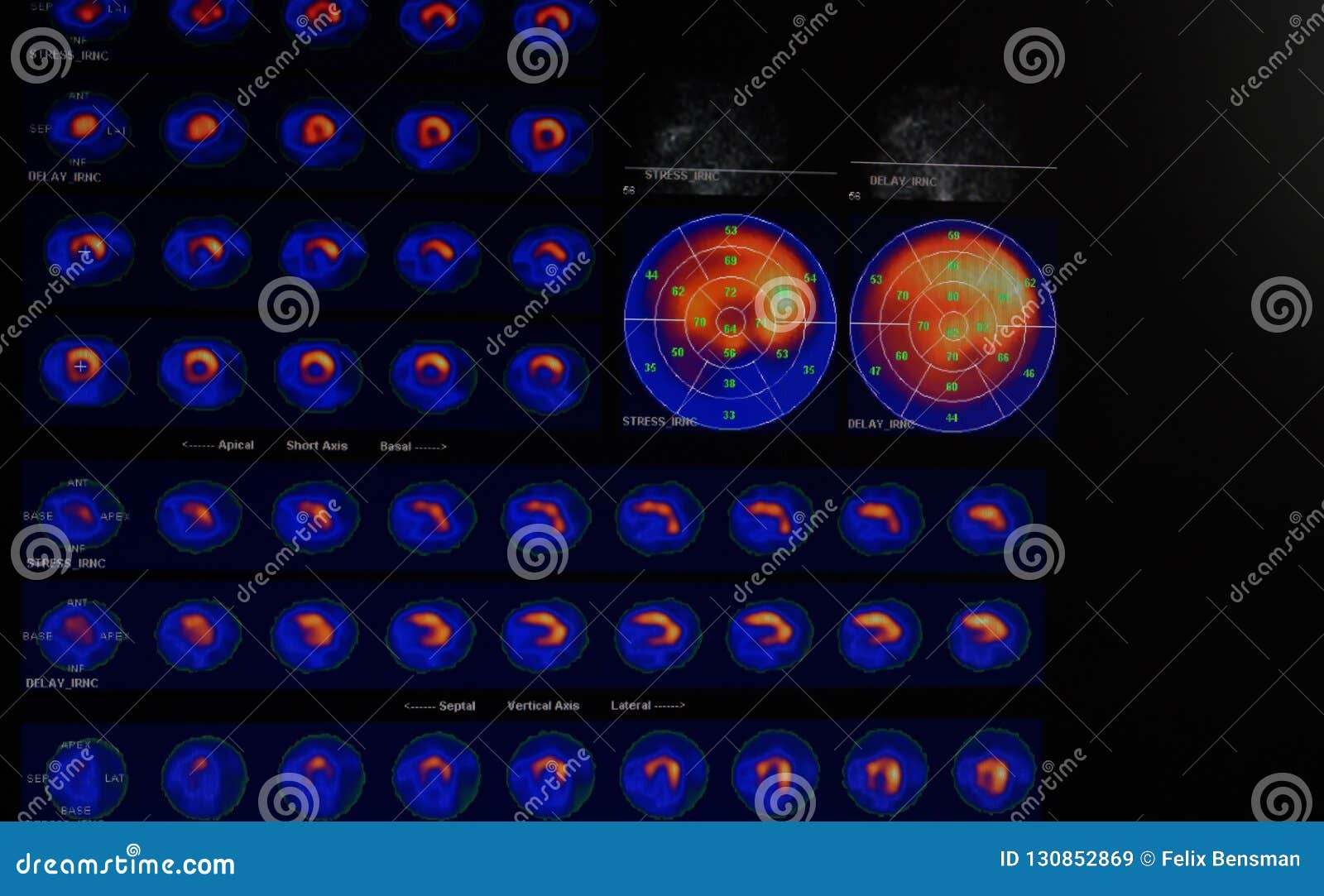 MRT of the Heart and Coronary Vessels Stock Image - Image of arrhythmia ...