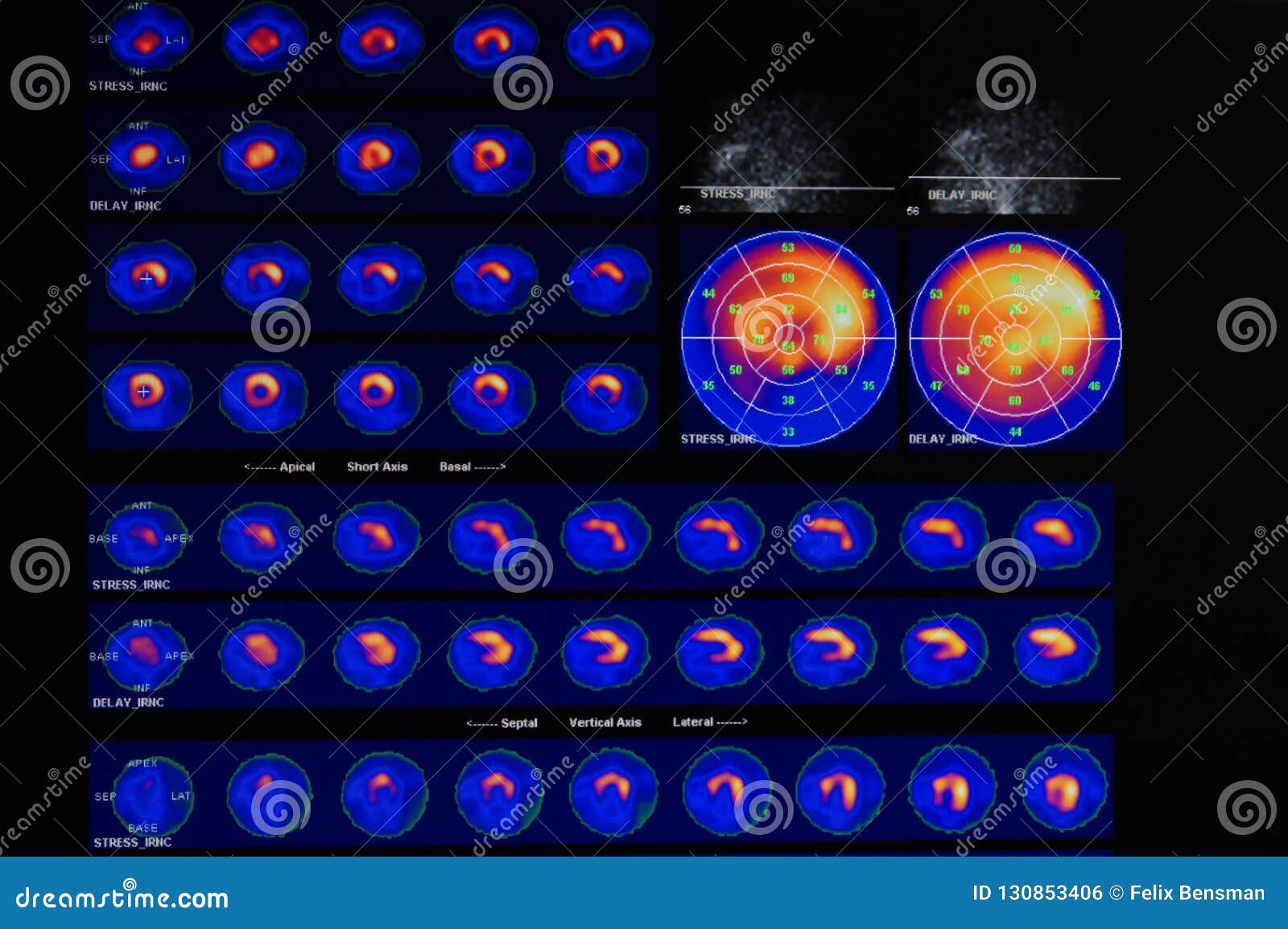 MRT of the Heart and Coronary Vessels Stock Photo - Image of cardiac ...
