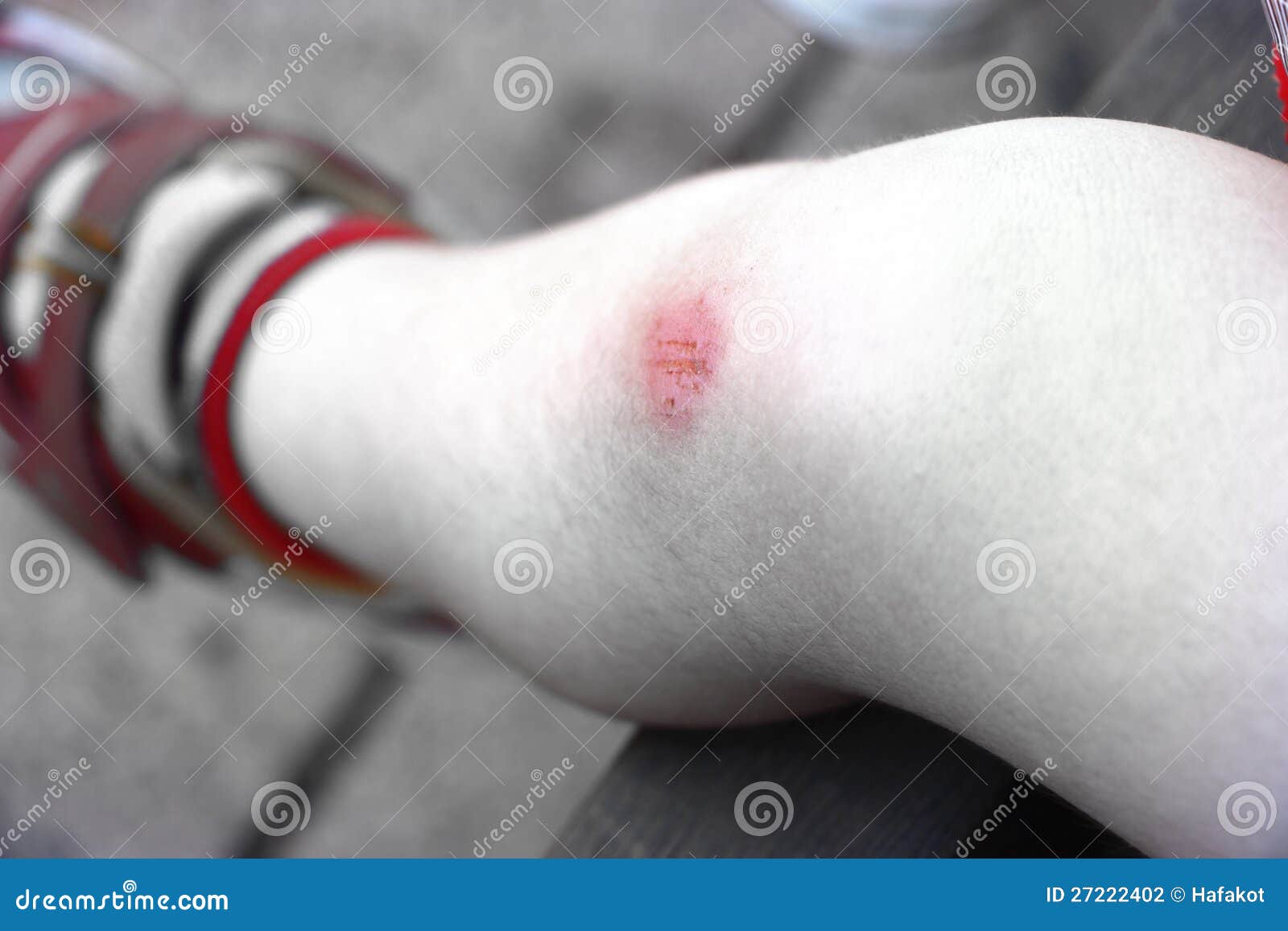 Muchacho Joven Con La Pierna Raspada Foto de archivo - Imagen de médico ...