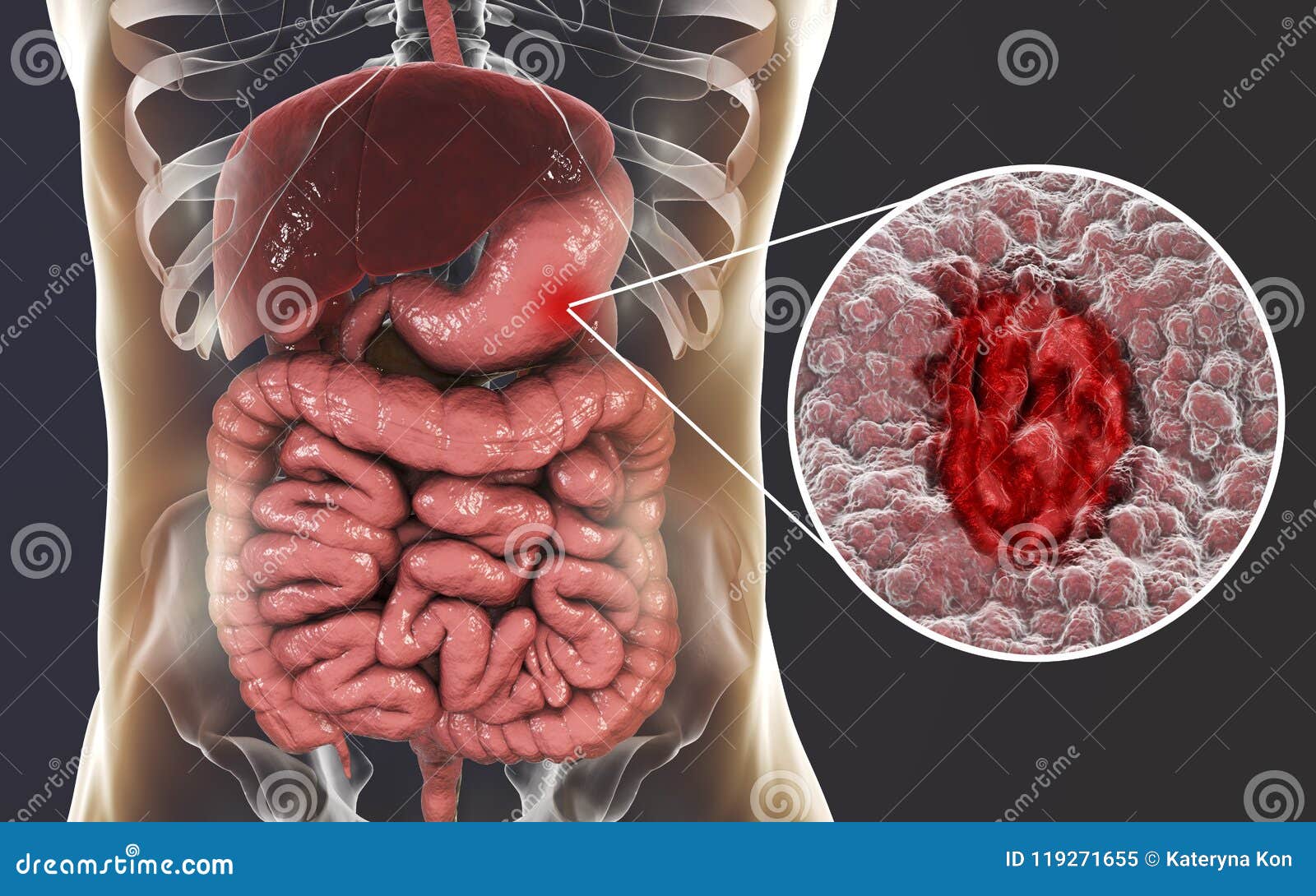 Mucosa Van Maag Met Maagzweer Stock Illustratie - Illustration of ...
