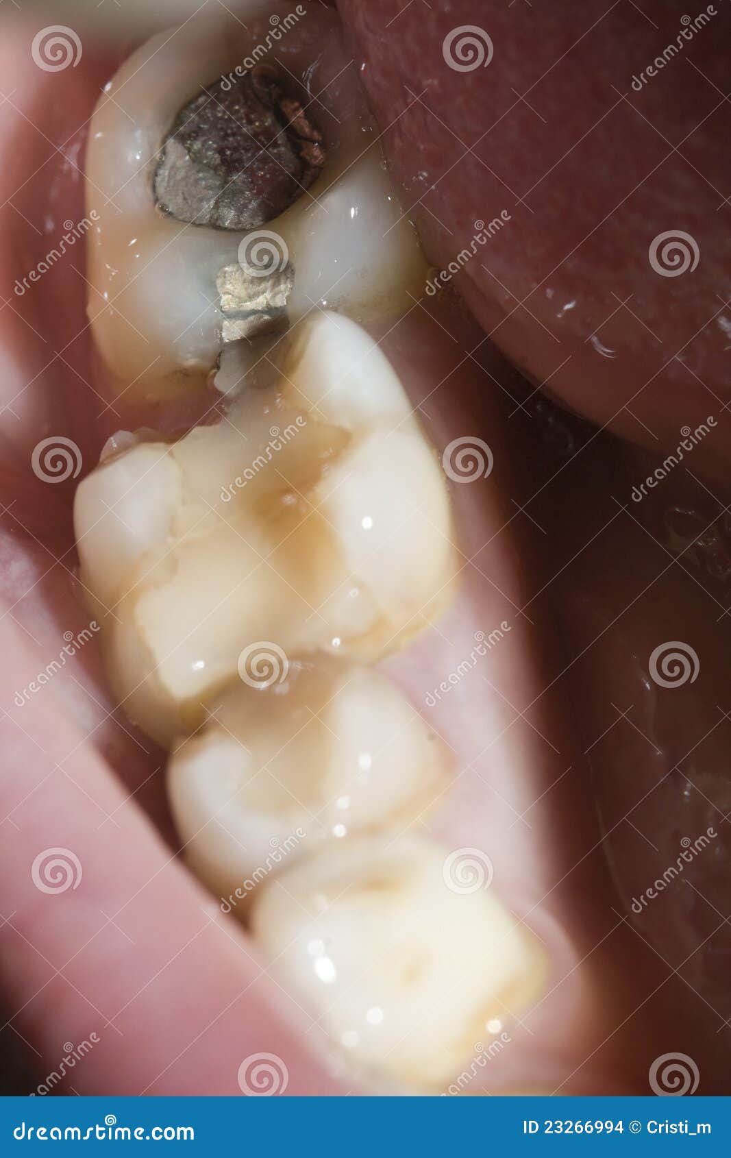 Muela quebrada foto de archivo. Imagen de paciente, cavidad - 23266994
