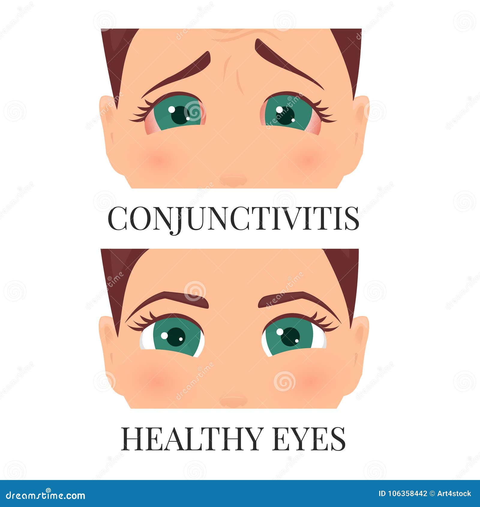 Mujer Con Conjuntivitis Ilustración Del Vector Ilustración De