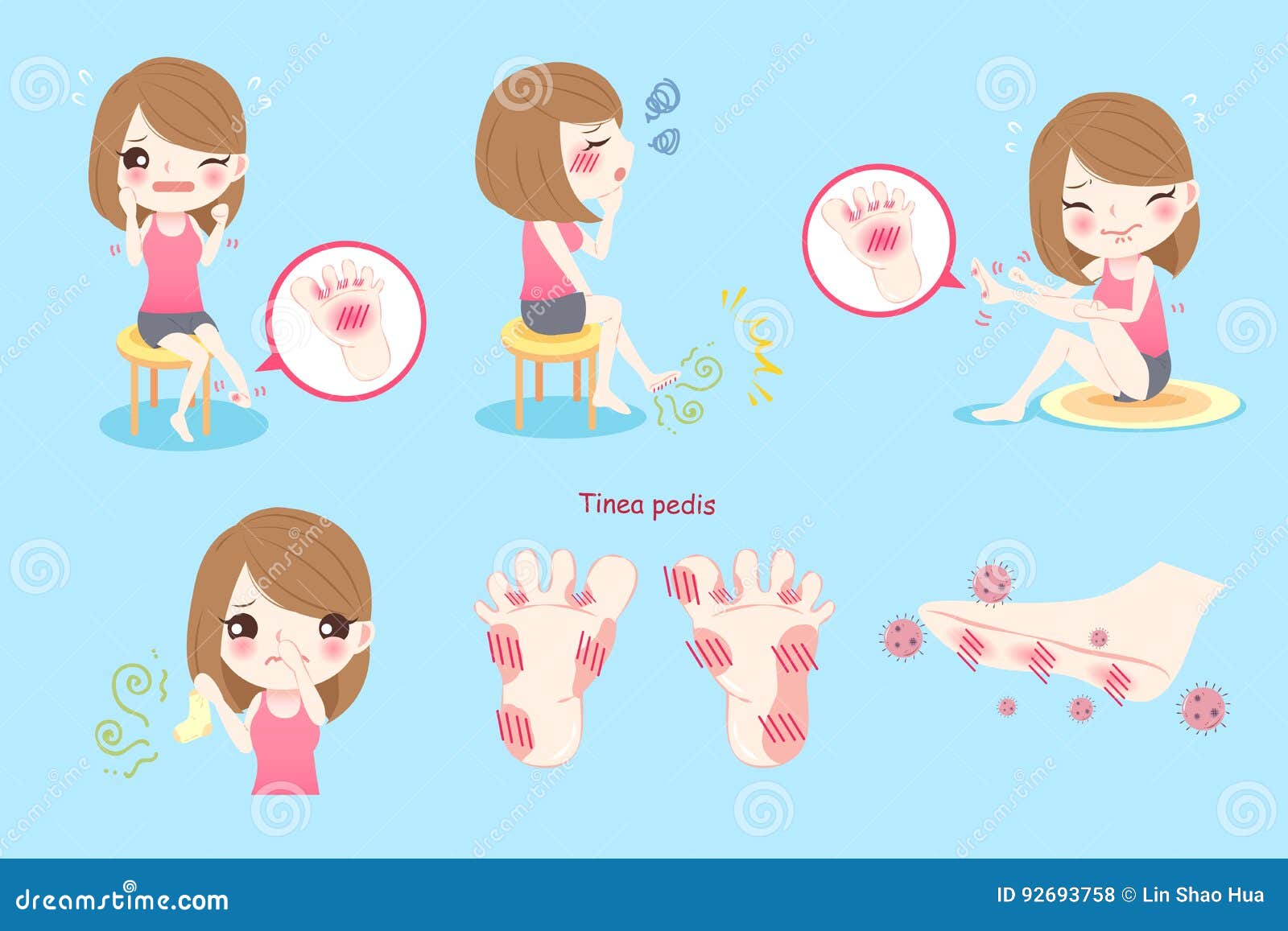 Mujer con pedis del tinea stock de ilustración. Ilustración de doloroso ...