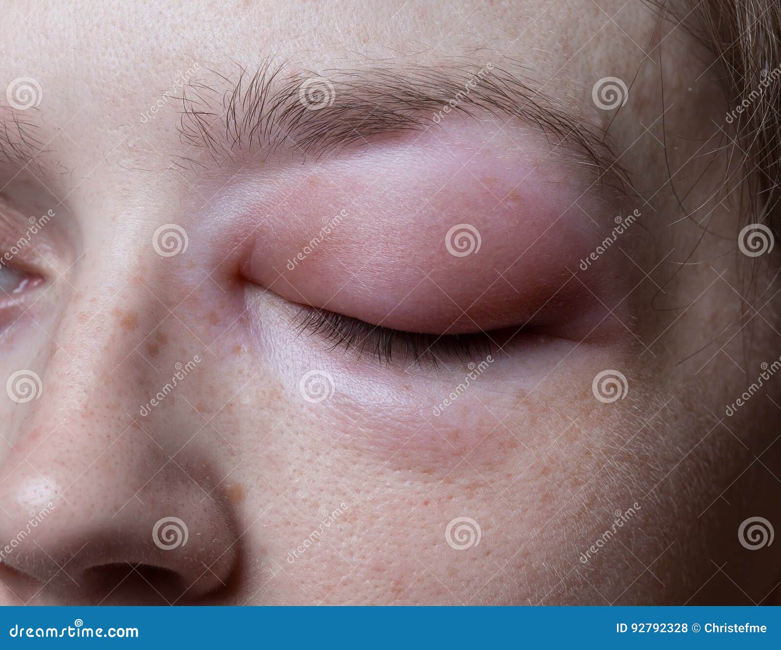 Sintético 96 Foto Fotos De Alergias En Los Ojos Mirada Tensa