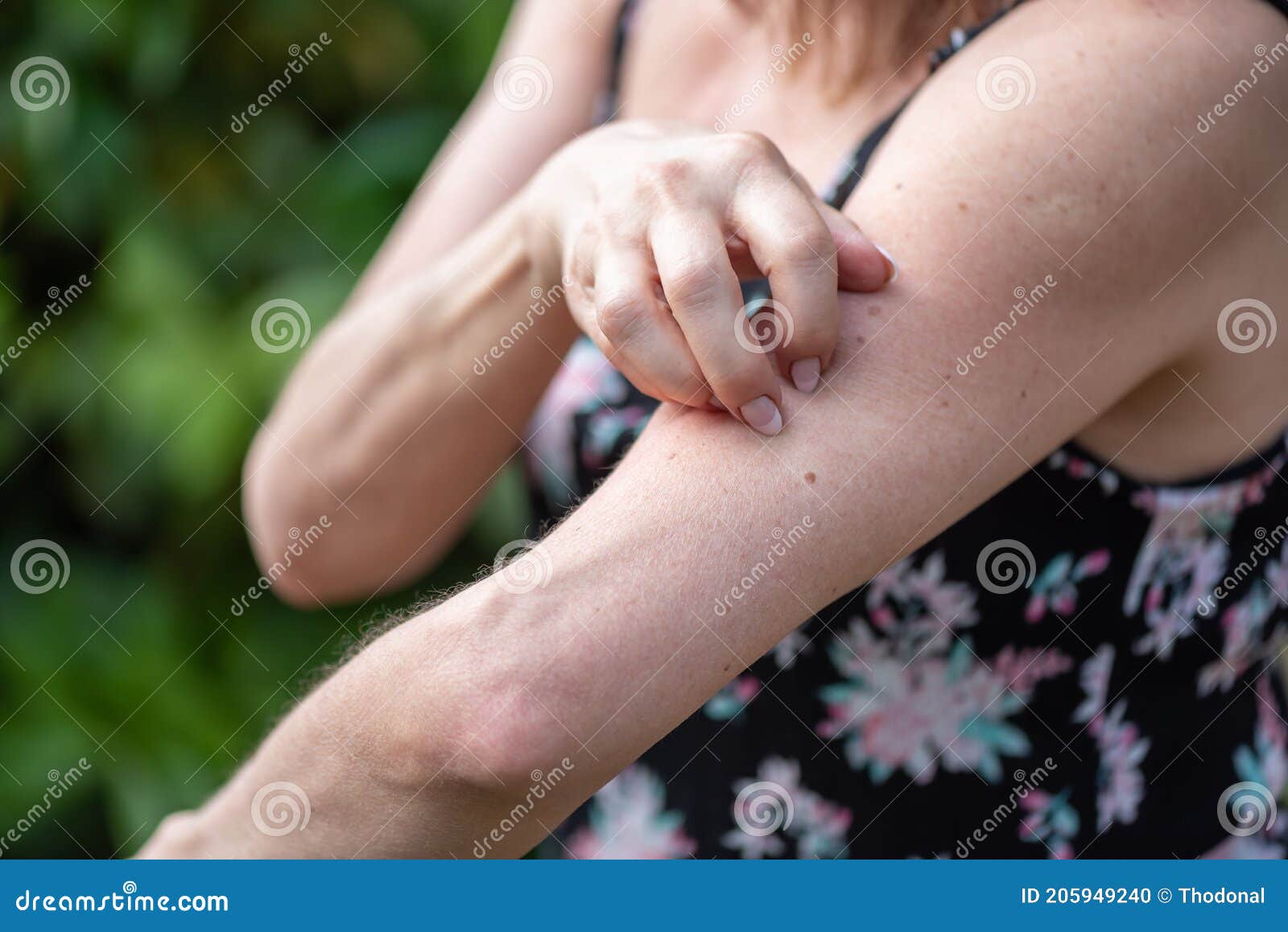 Mujer rascando su brazo foto de archivo. Imagen de picor - 205949240