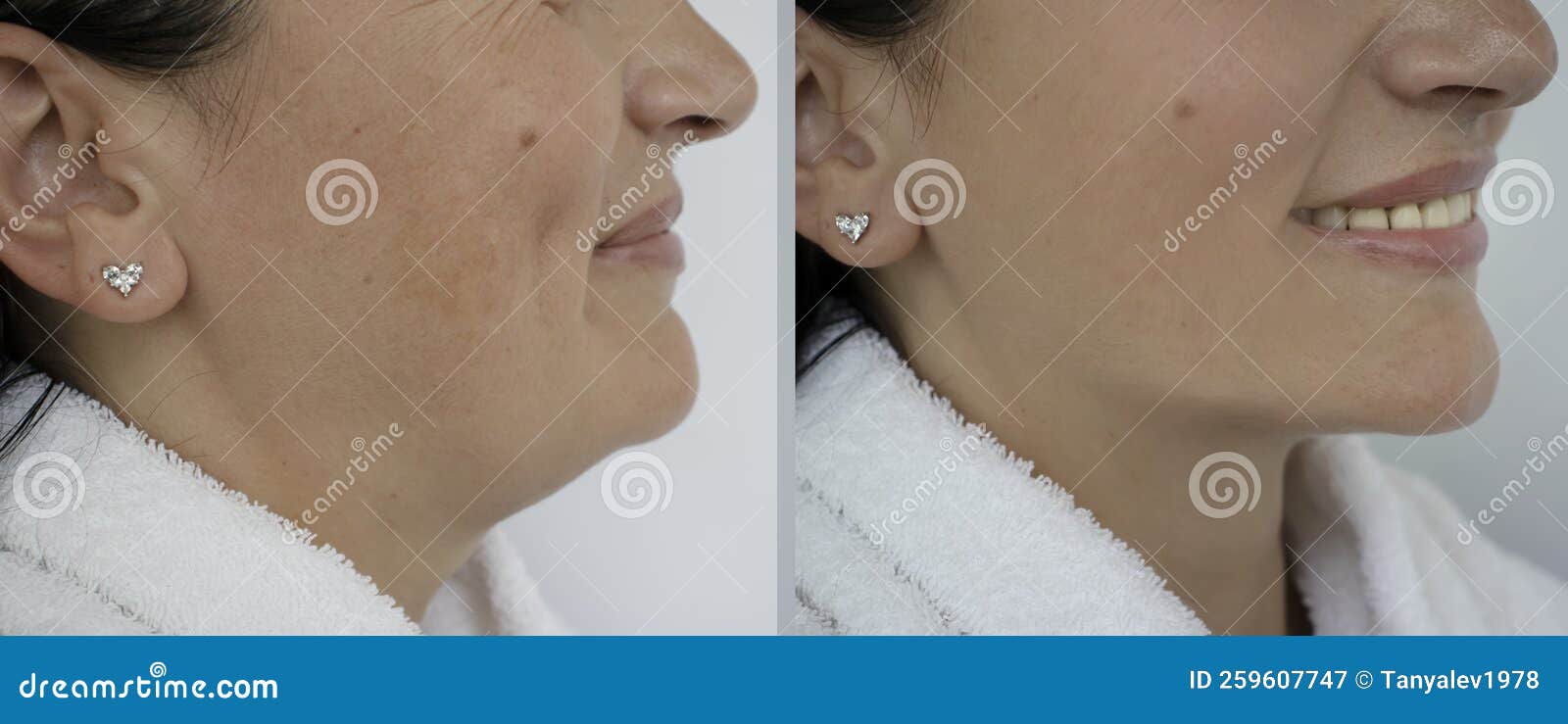 Mulher Com Duplo Queixo Antes E Depois Do Tratamento Imagem de Stock ...