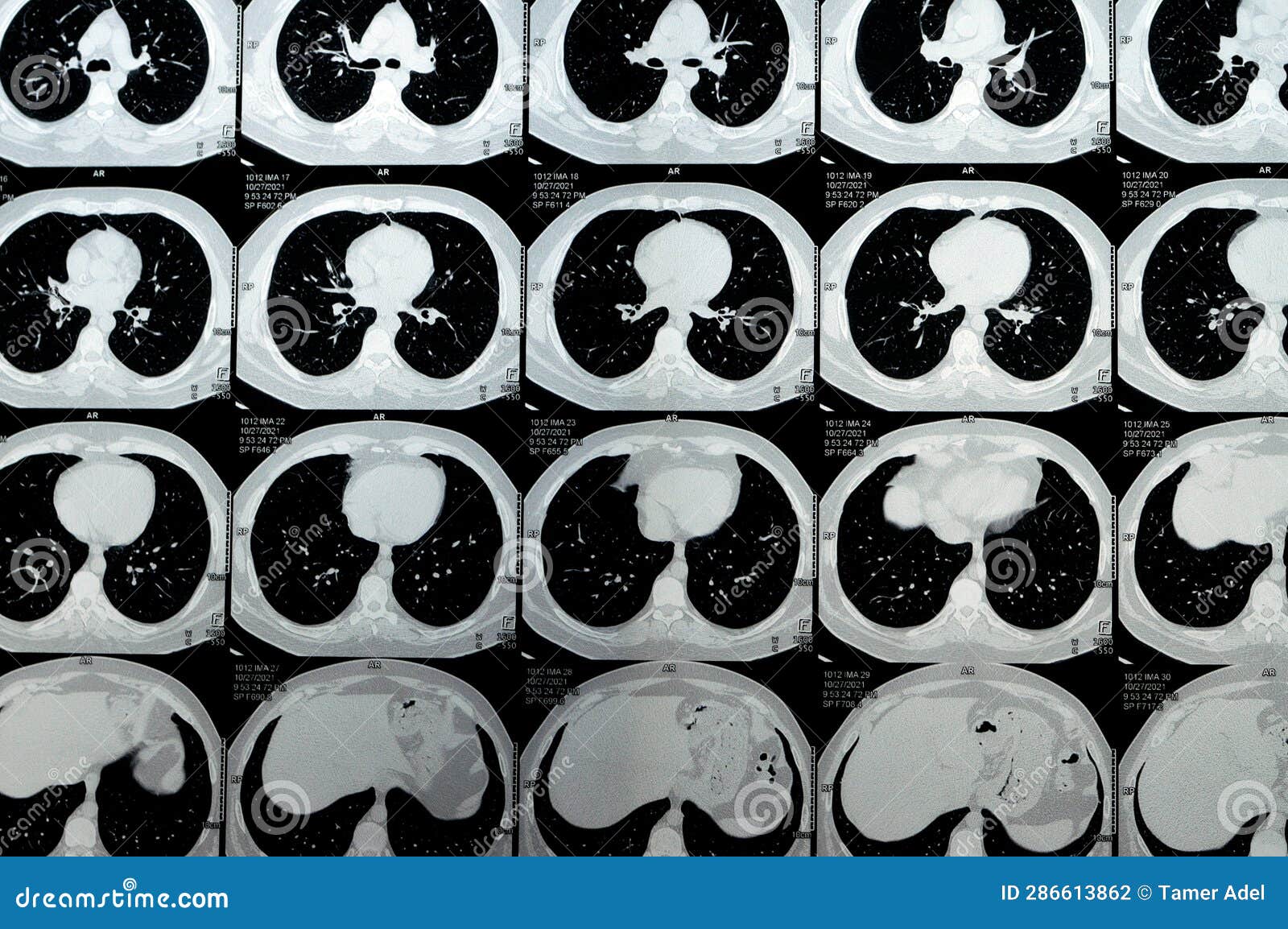 Multi Slice CT Scan of the Chest Showing Normal Study, Normal ...