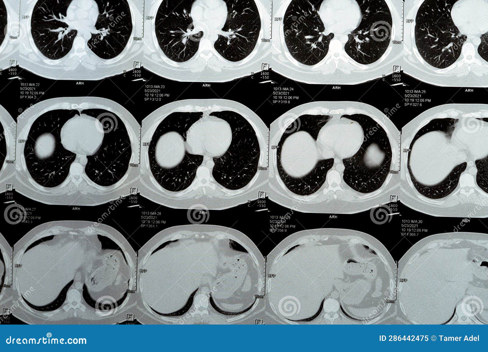 Multi Slice CT Scan Of The Brain Showing Large Brain Stem And Right ...