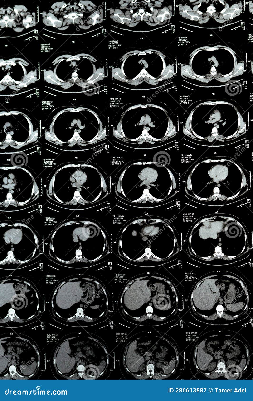 Multi Slice CT Scan of the Chest Showing Normal Study, Normal ...