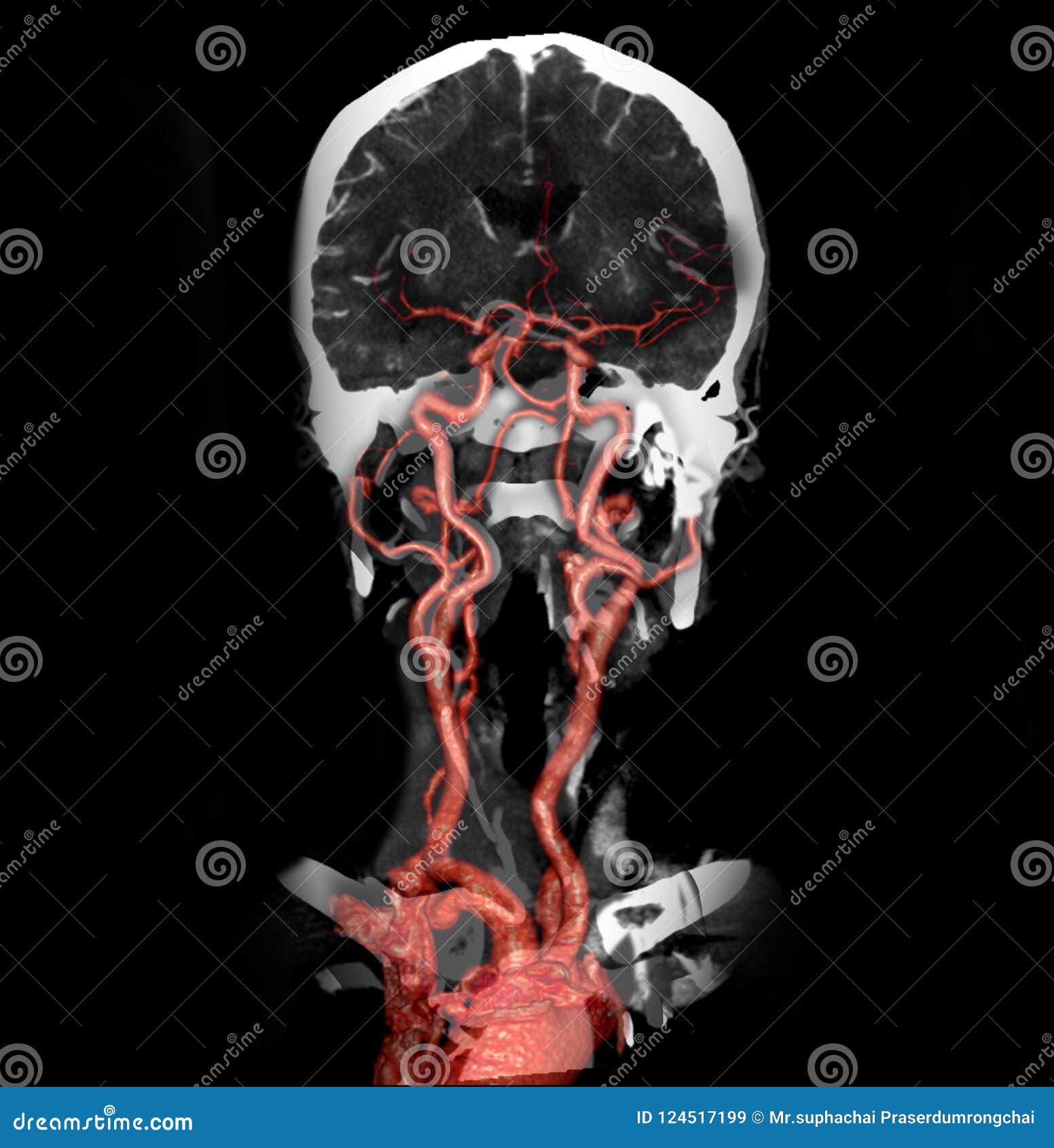 CTA BRAIN Or CT Angiography Of The Brain 3D Rendering Image AP And ...