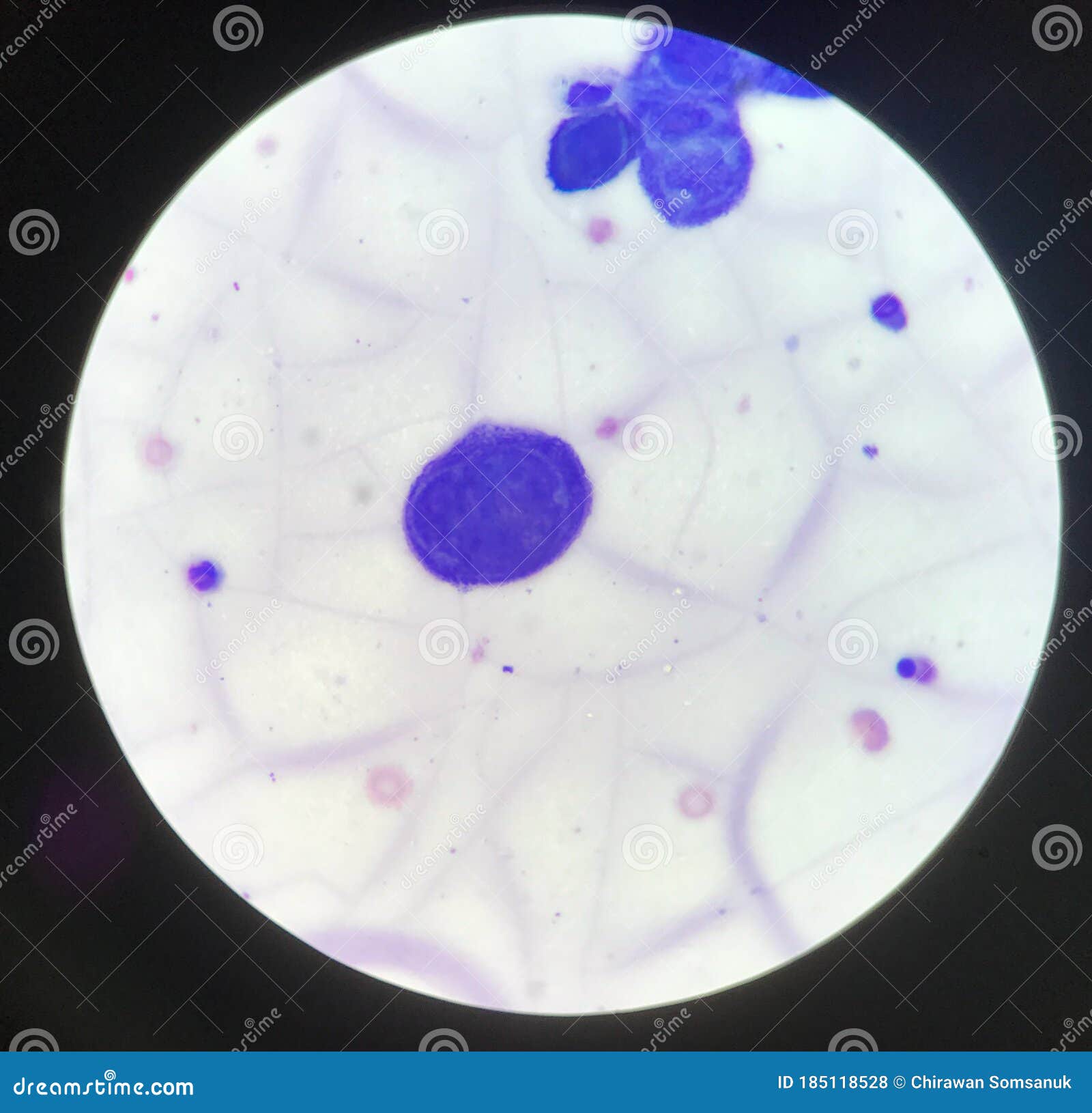 Multinucleated Cell in Tzanck Test Stock Photo - Image of sample ...