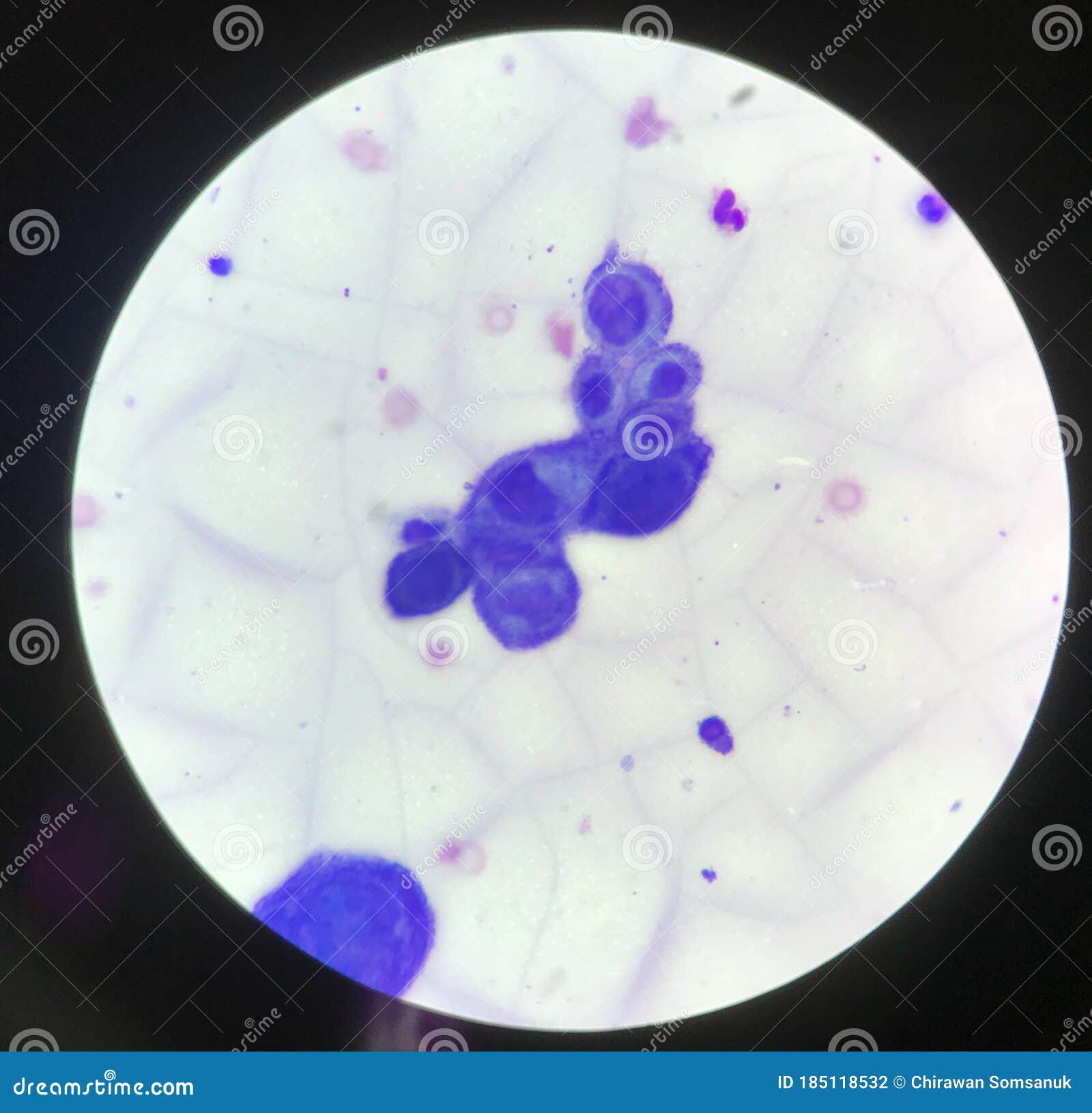 Tzanck Smear Multinucleated Giant Cells