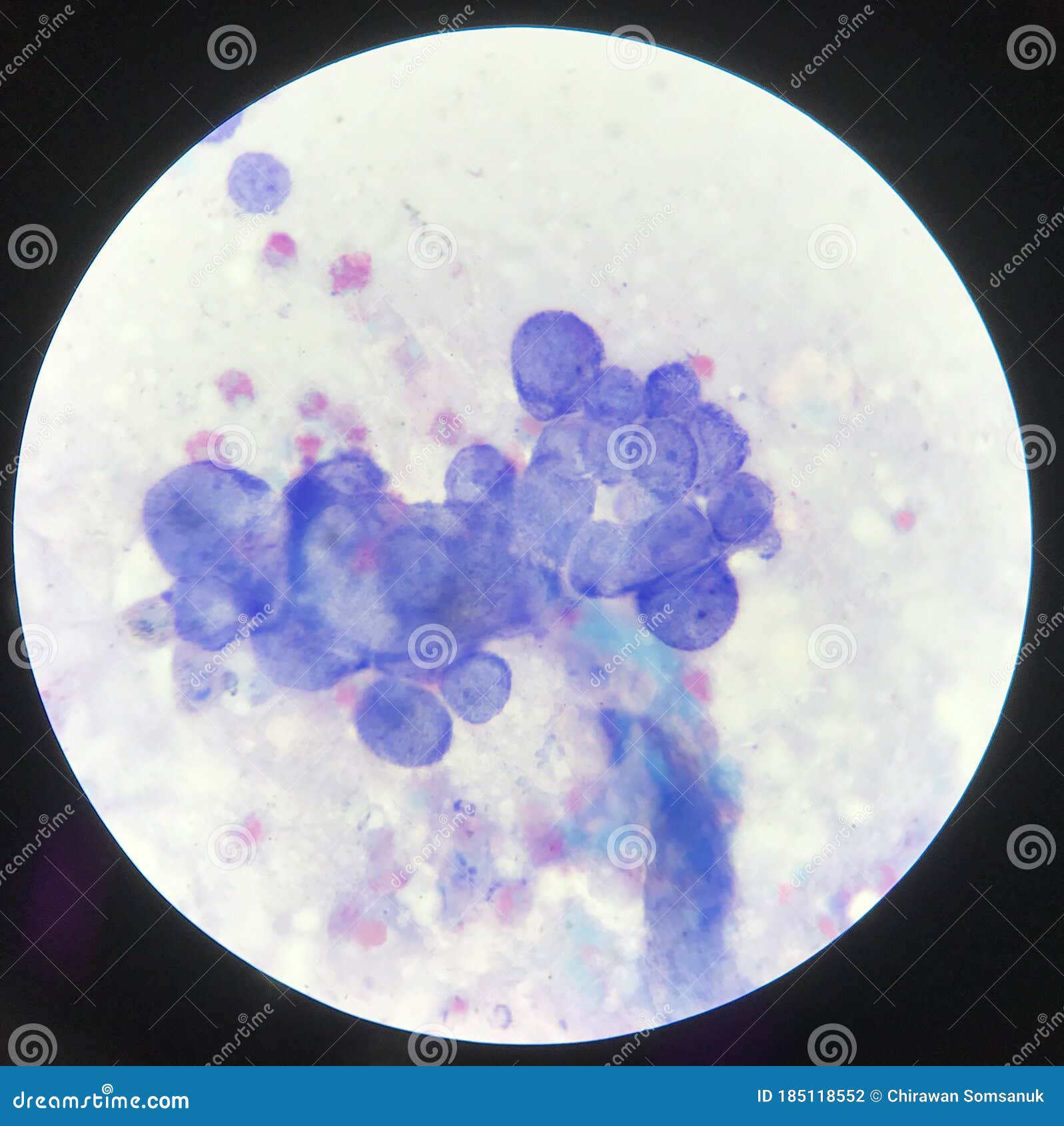 Tzanck Smear Multinucleated Giant Cells