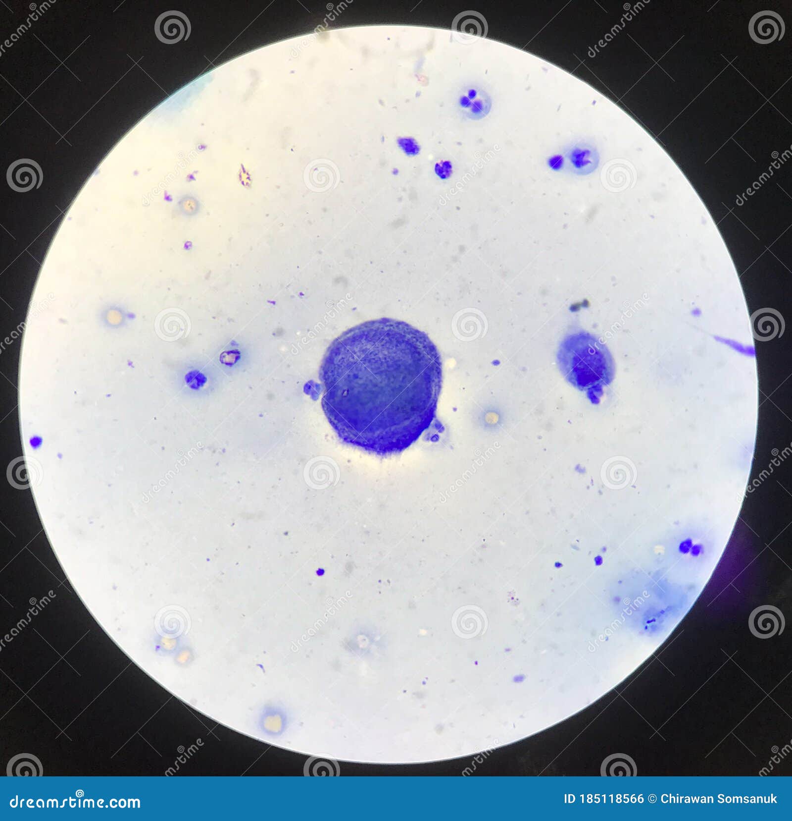 Multinucleated Cell in Tzanck Test Stock Photo - Image of microscope ...